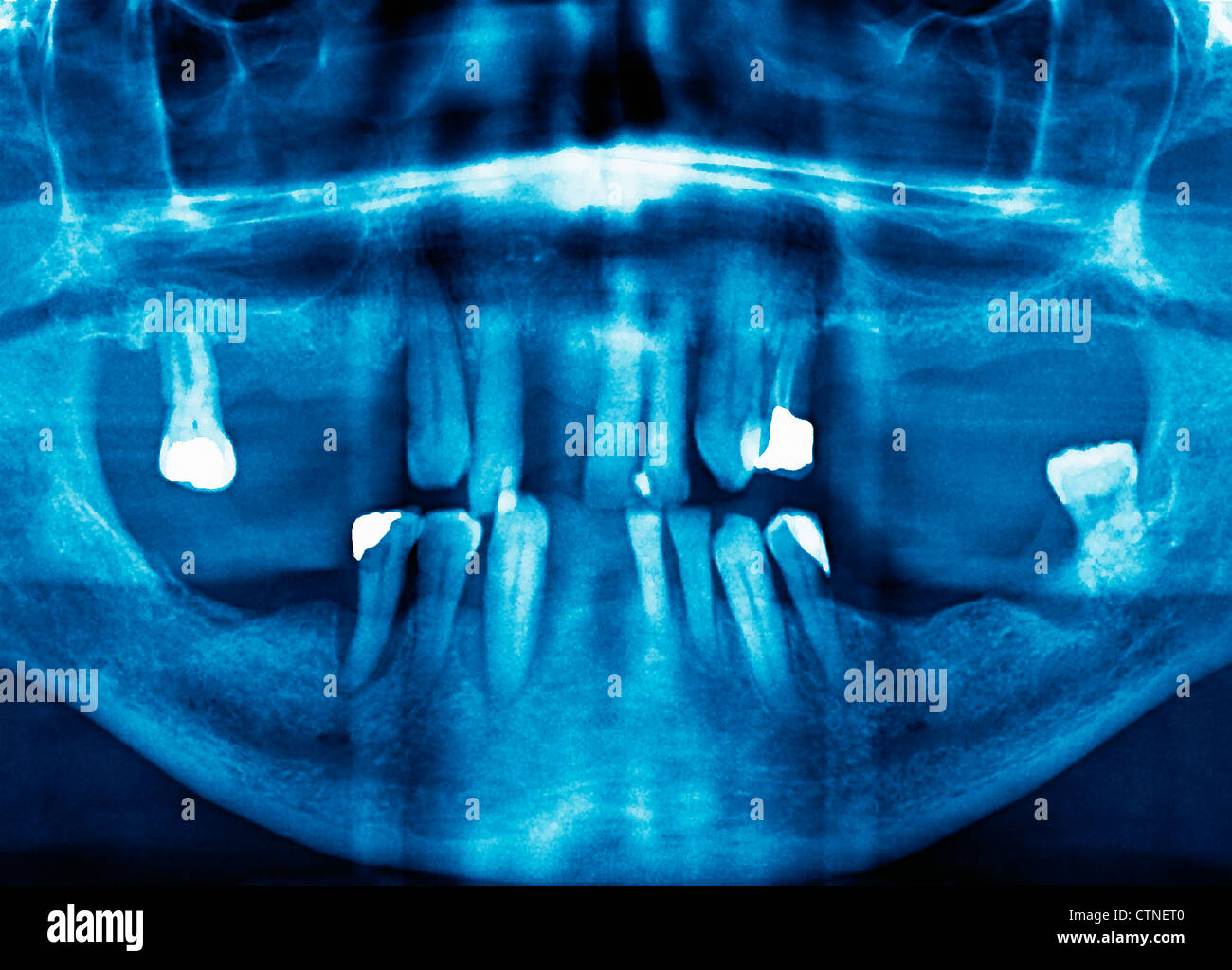 Orthopantomogram Opg Orthopantomogramm