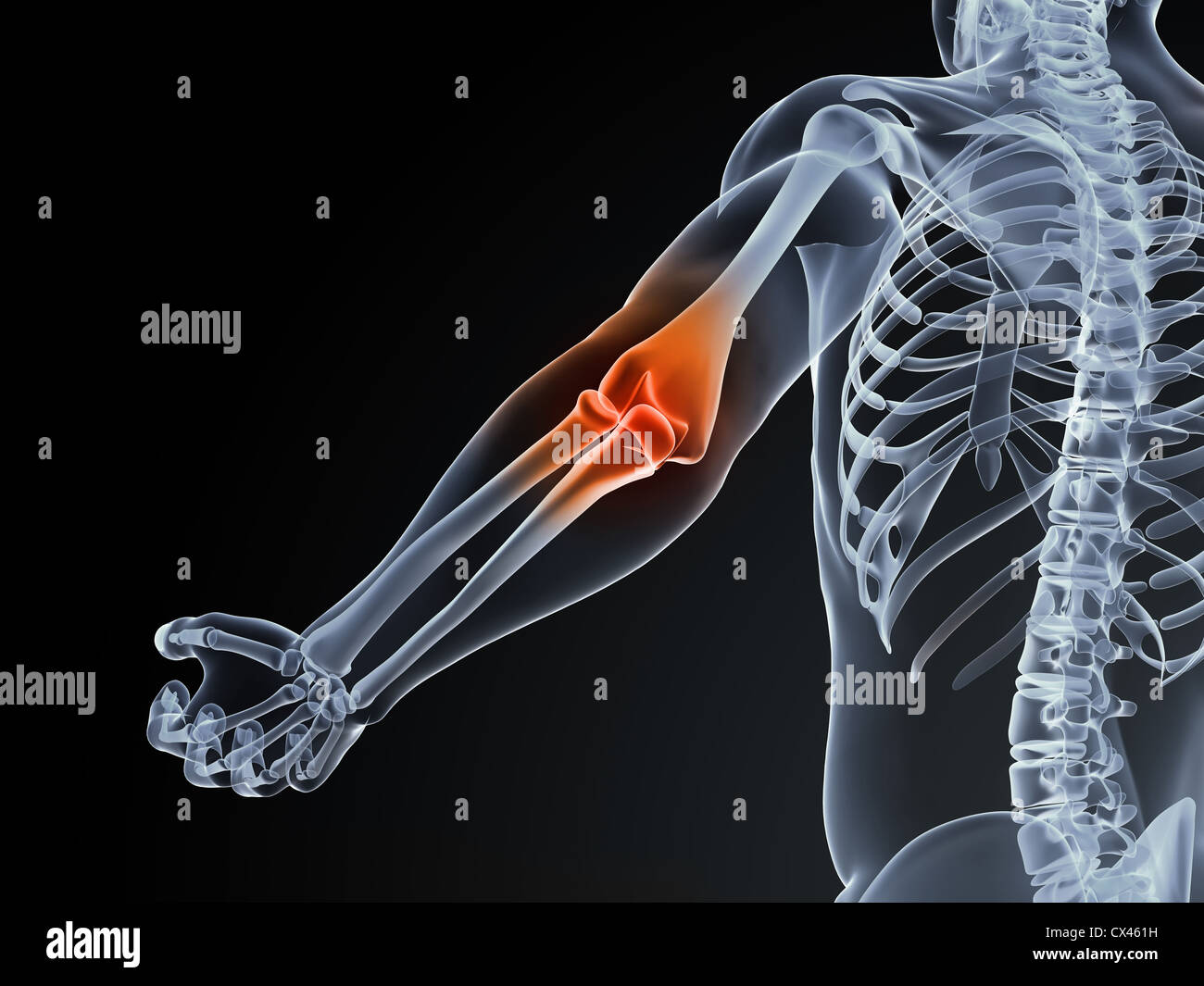 3D gerenderten medizinische Illustration der ein Ellenbogen Bursitis ...