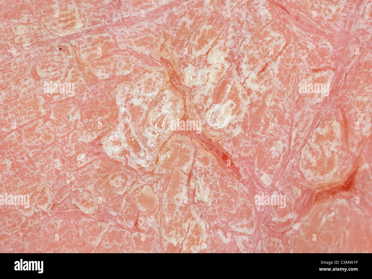 Dermatitis Palme verursacht durch berufliche Exposition zeigen Skala ...