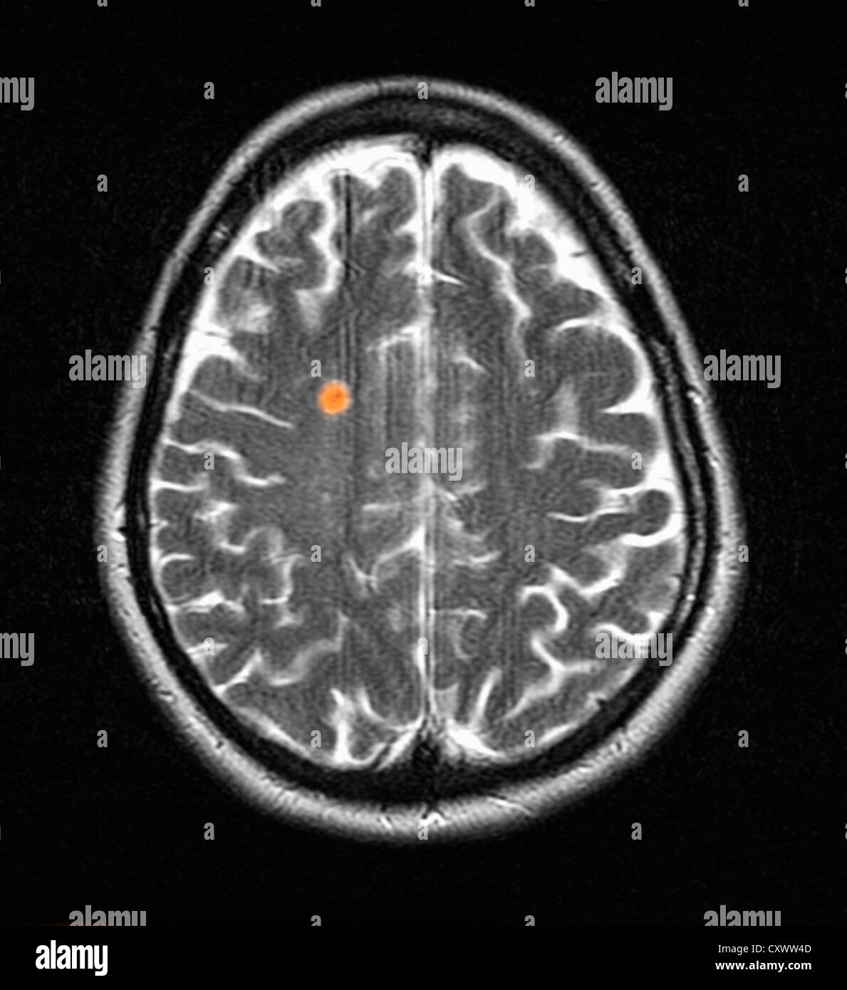 Koronales mri bild -Fotos und -Bildmaterial in hoher Auflösung – Alamy