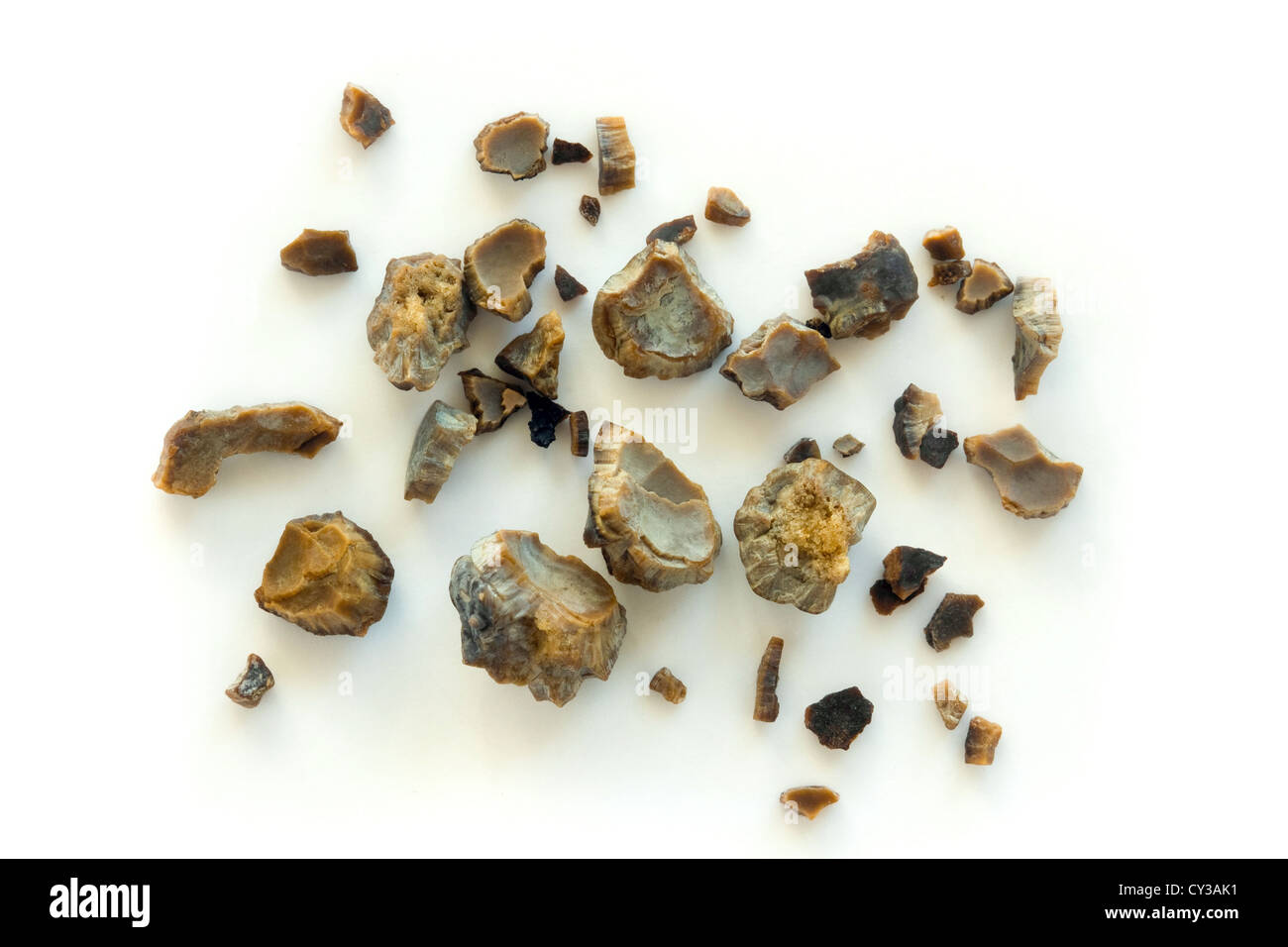 Nierensteine nach ESWL Intervention. Lithotripsie. Makroaufnahme ...