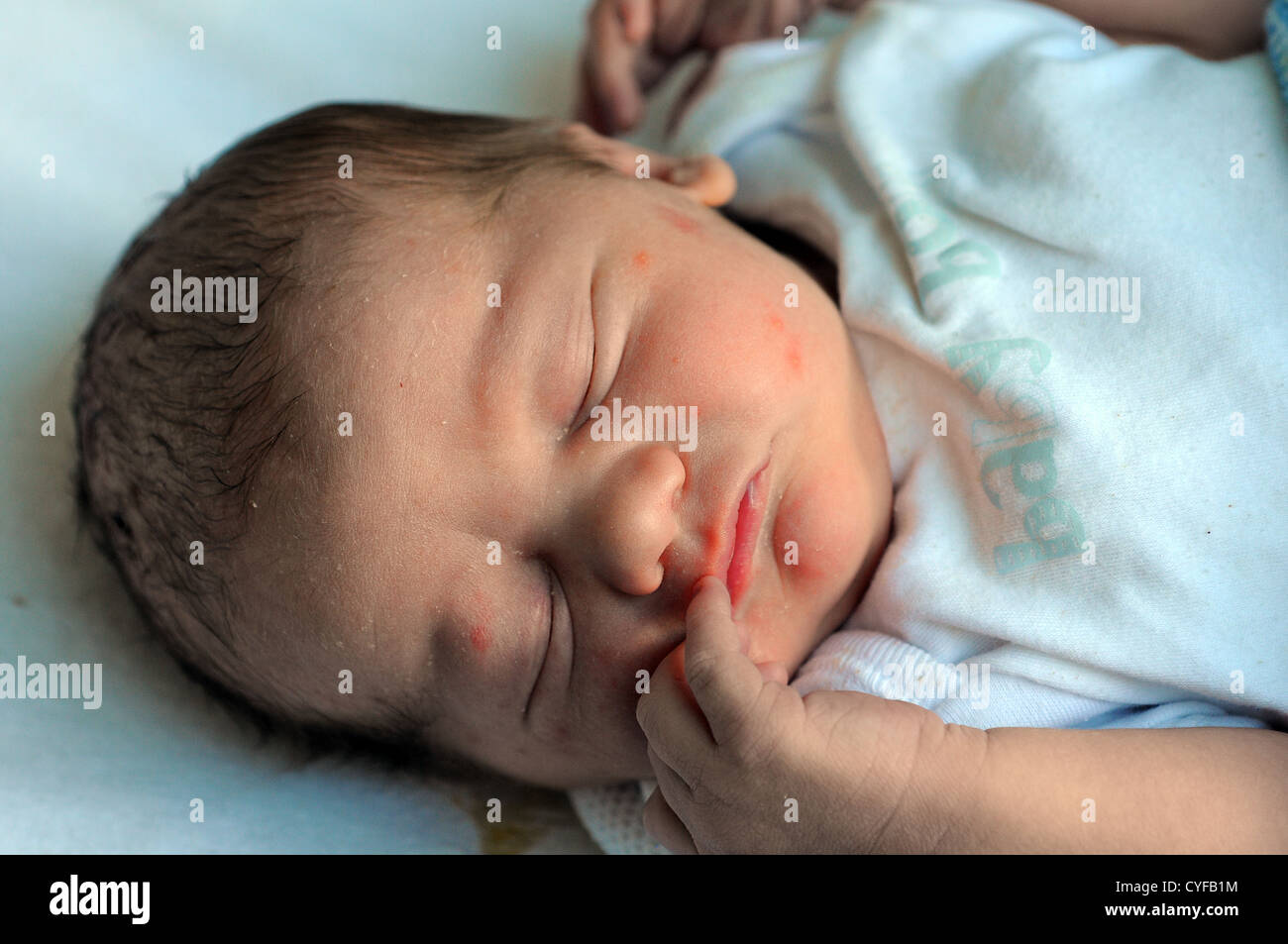 Baby-Akne, Erythema Toxicum Neonatorum (ETN) wird oft auf Erythema ...