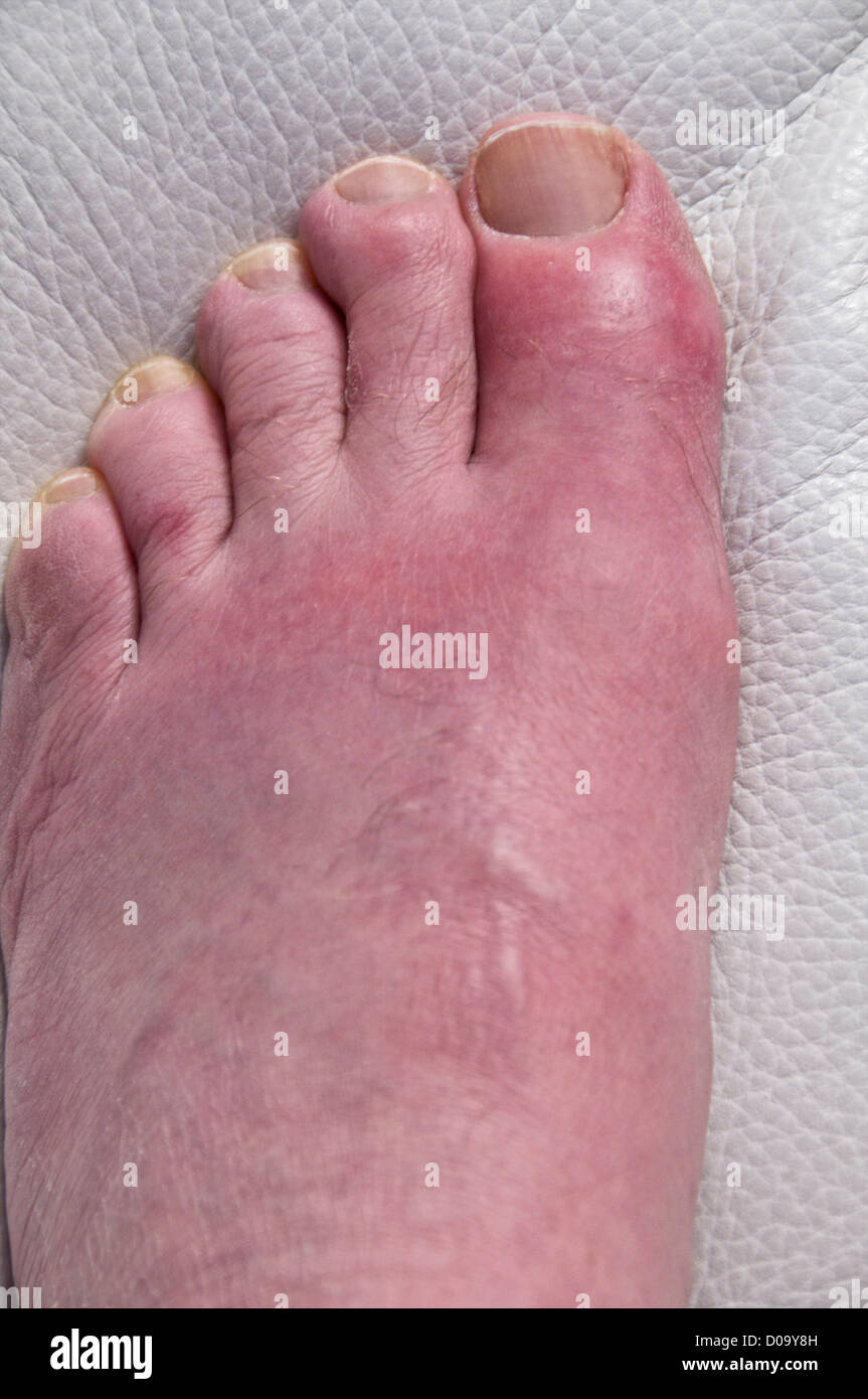 Gicht fuss -Fotos und -Bildmaterial in hoher Auflösung – Alamy