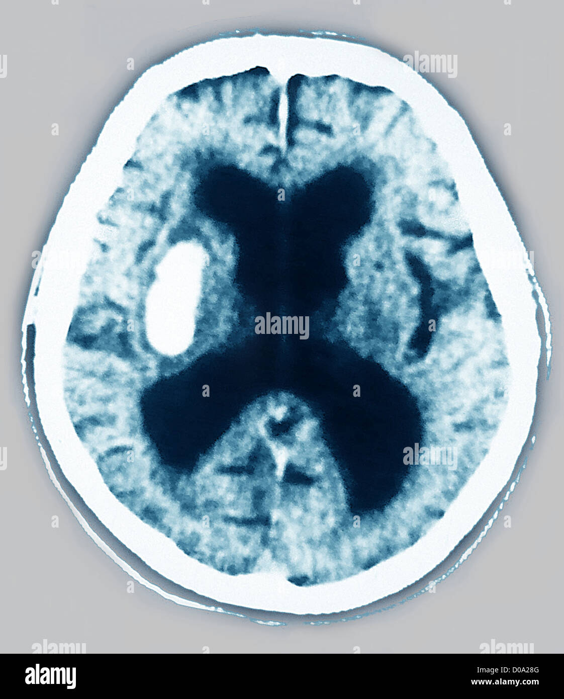 Intrazerebrale Blutung Stockfotos und -bilder Kaufen - Alamy