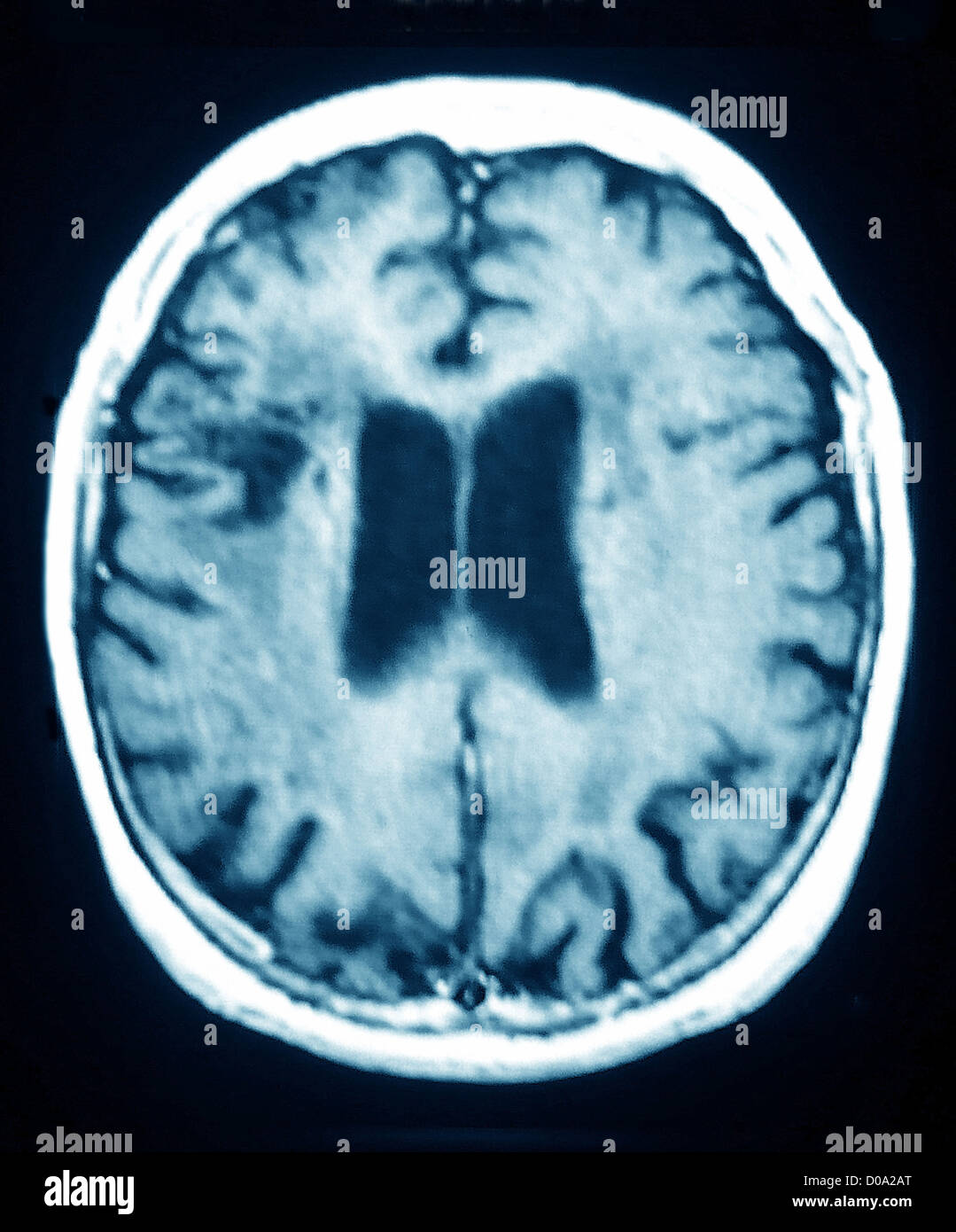 X syndrom -Fotos und -Bildmaterial in hoher Auflösung – Alamy