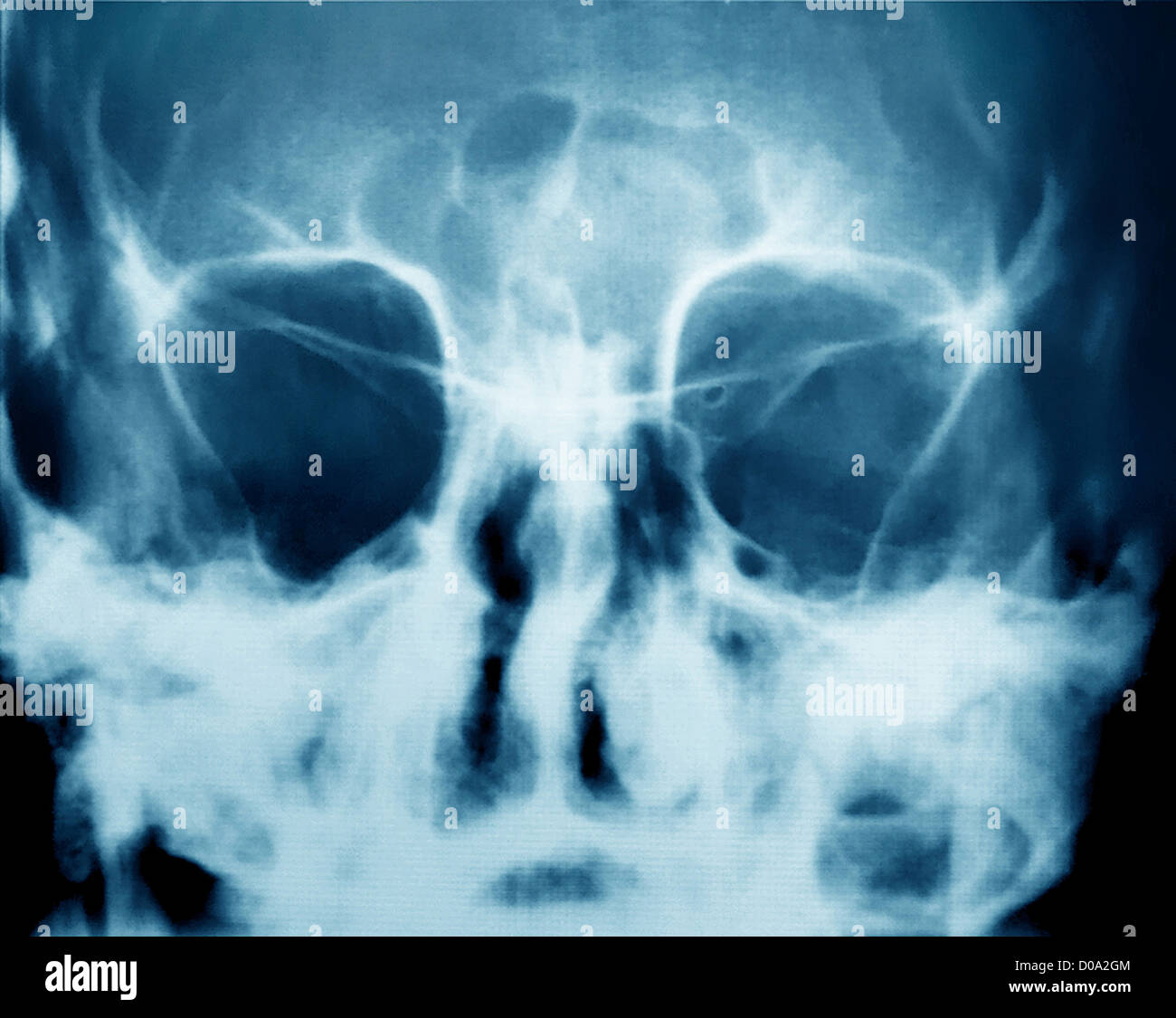 Nasal polyps -Fotos und -Bildmaterial in hoher Auflösung – Alamy