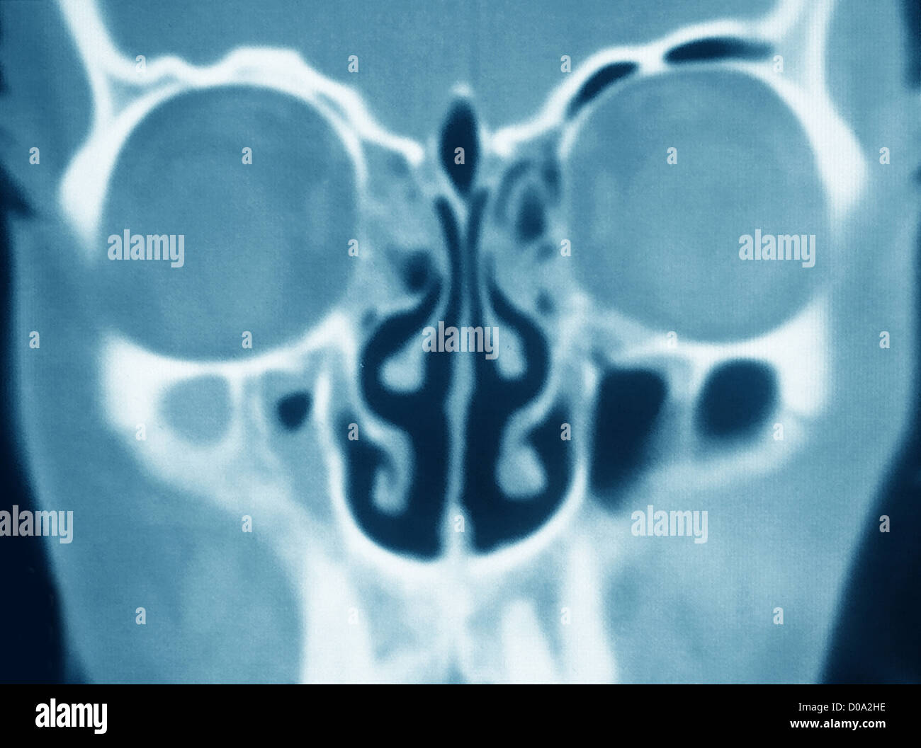Nasal polyps -Fotos und -Bildmaterial in hoher Auflösung – Alamy