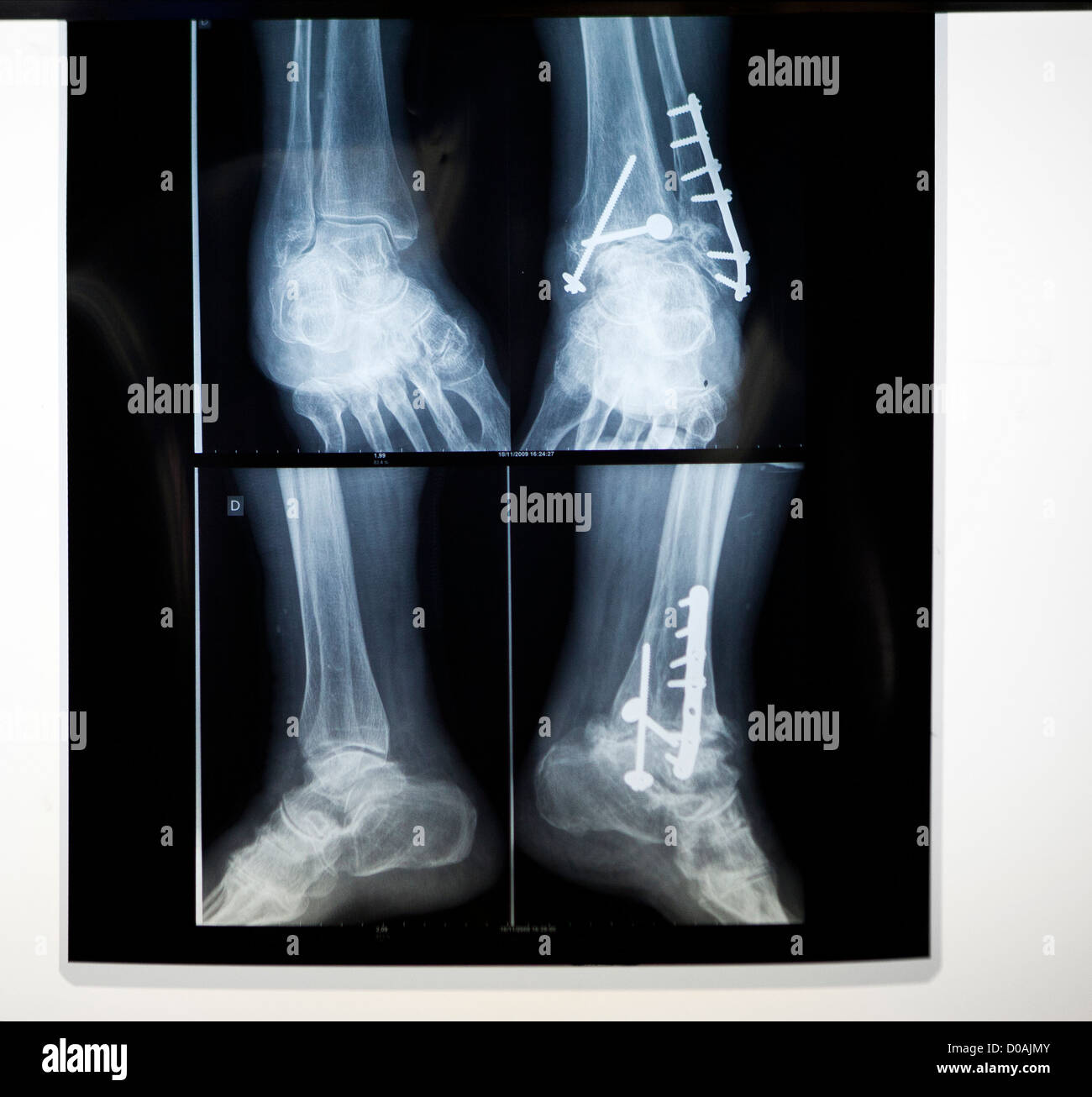 KNÖCHEL OSTEOSYNTHESE, X-RAY Stockfotografie - Alamy