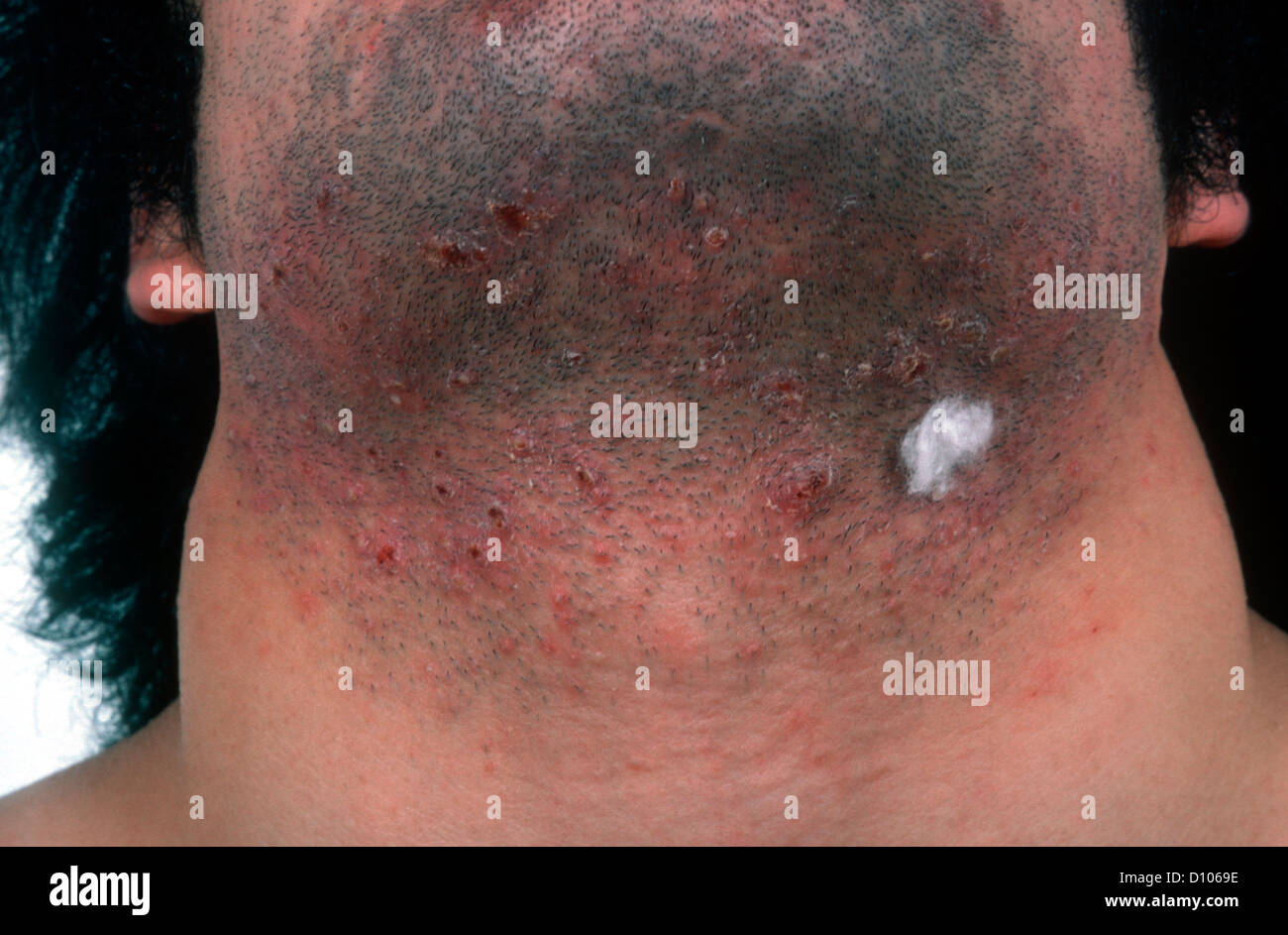 Sykosis vulgaris -Fotos und -Bildmaterial in hoher Auflösung – Alamy