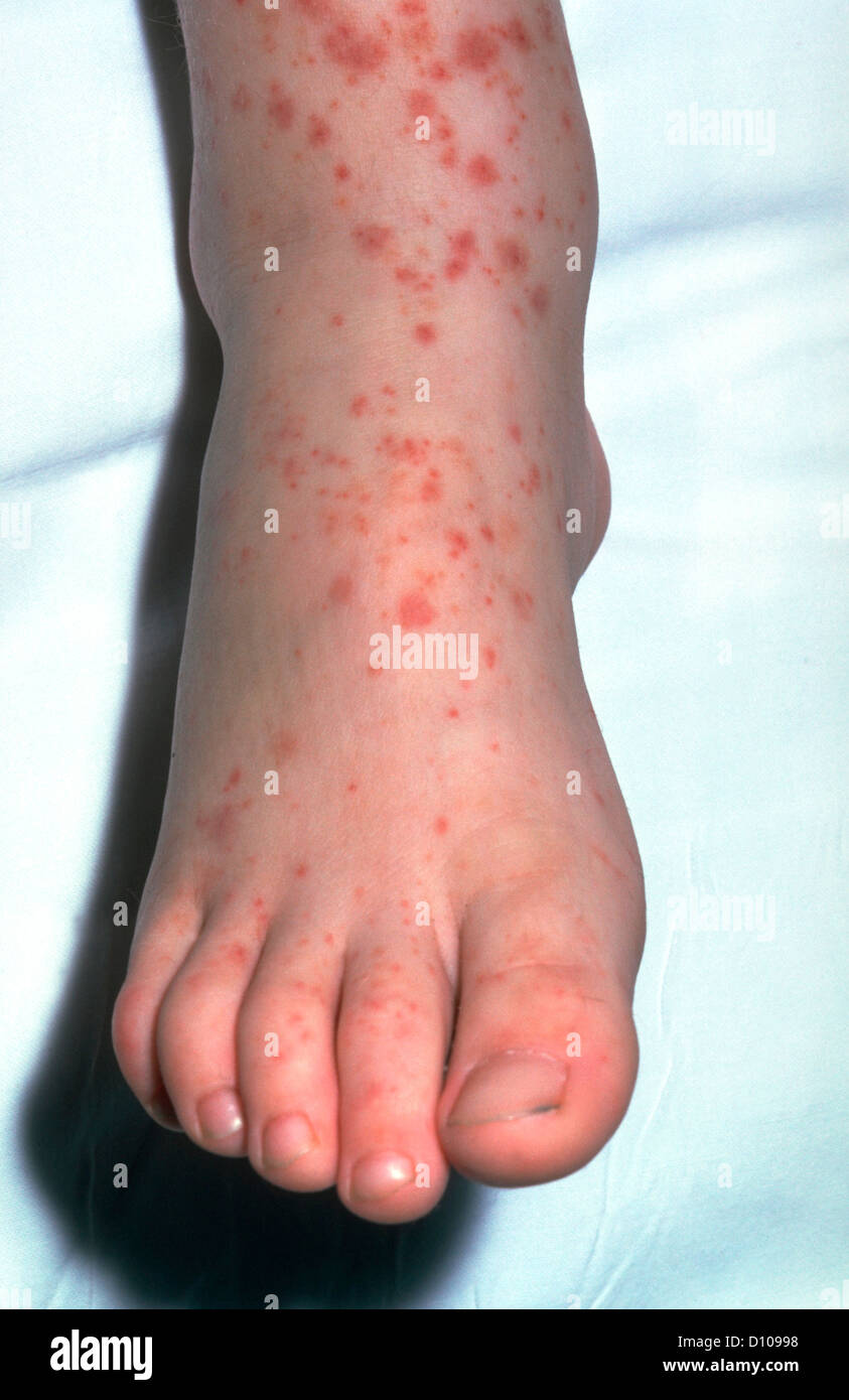 Purpura rash -Fotos und -Bildmaterial in hoher Auflösung – Alamy