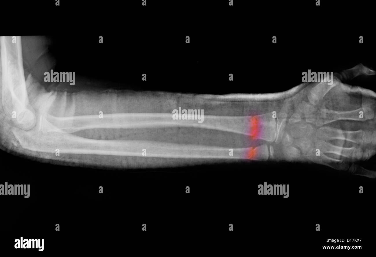Röntgenbild einer distalen Unterarm-Fraktur Stockfotografie - Alamy