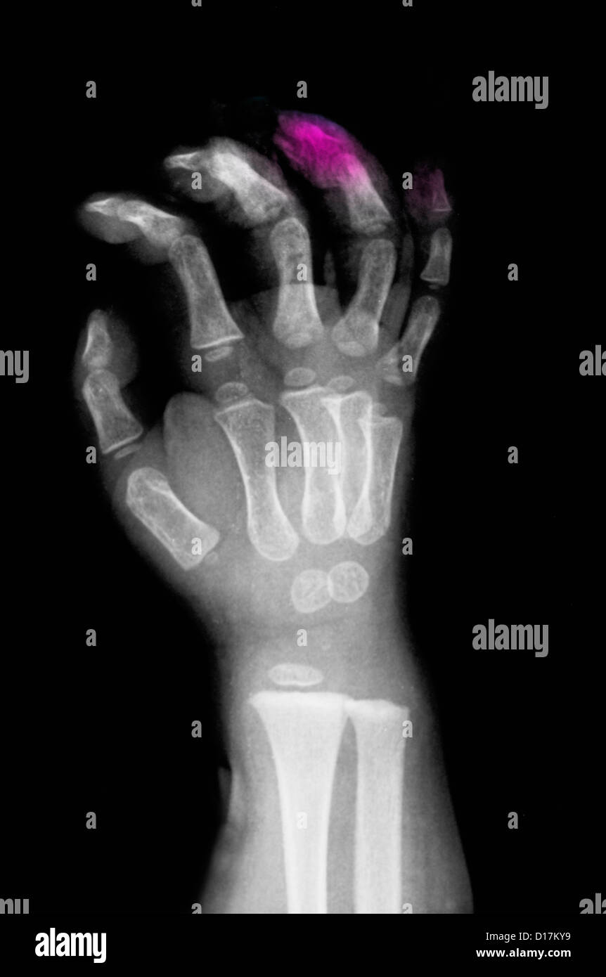 Child Hand X Ray Stockfotos und -bilder Kaufen - Alamy