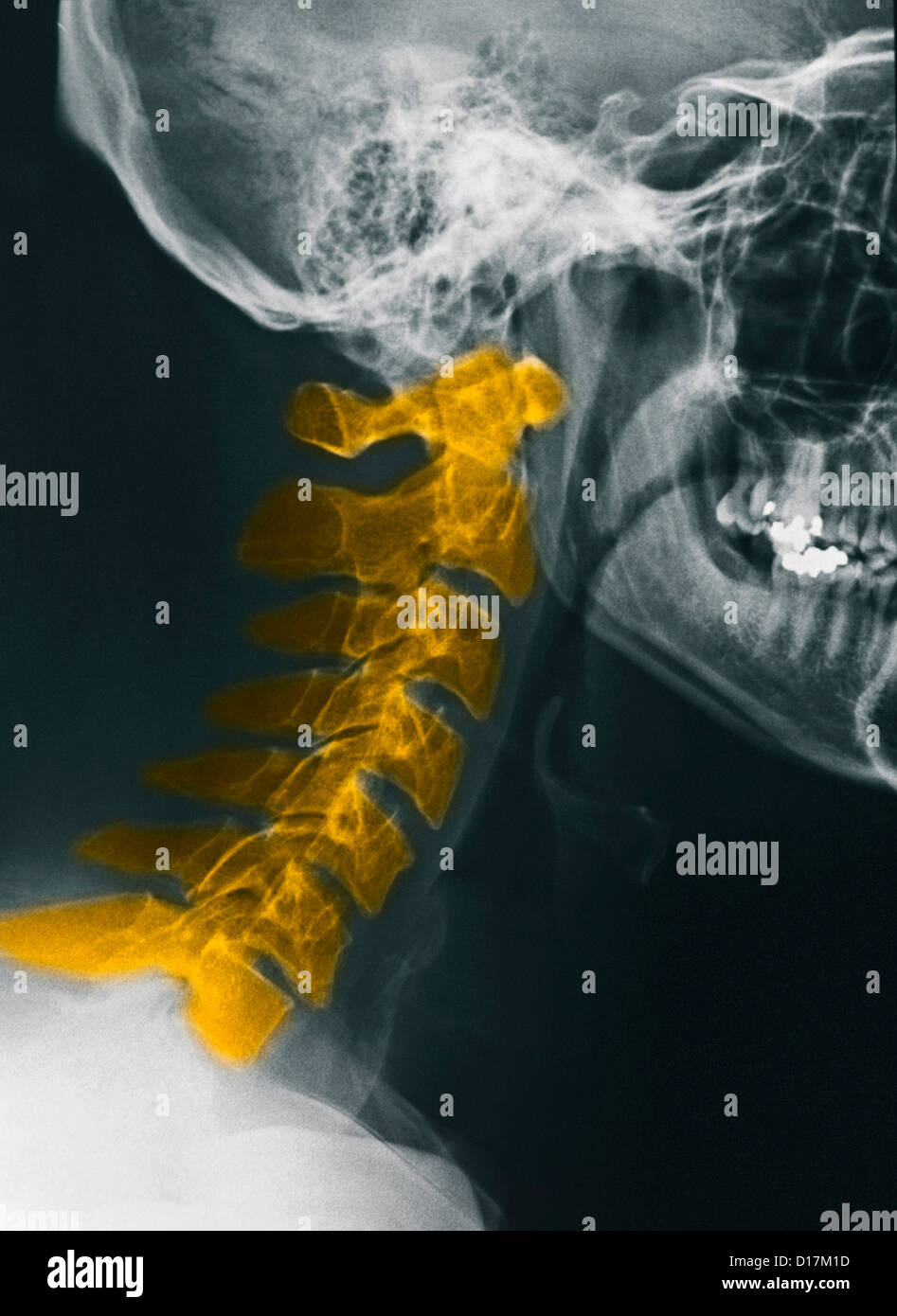 Neck Spine X Ray Close Up Stockfotos & Neck Spine X Ray Close Up Bilder ...