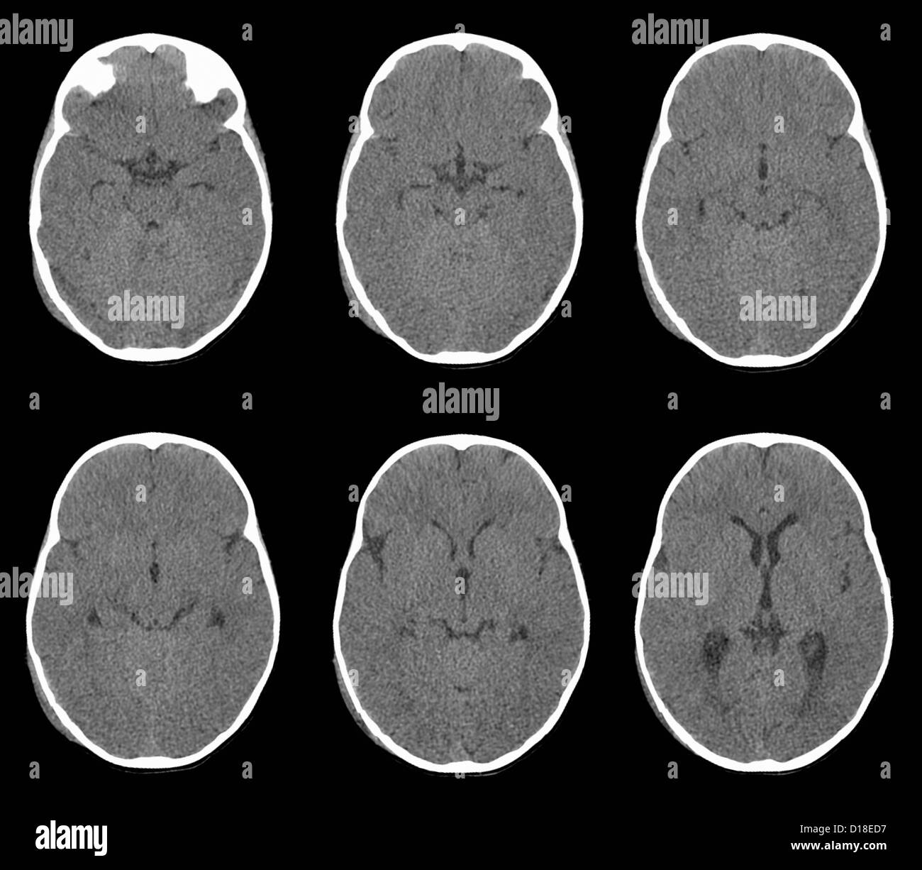 Kopf CT-Scan, Mädchen, Fraktur, subdurale Hämatom Stockfotografie - Alamy