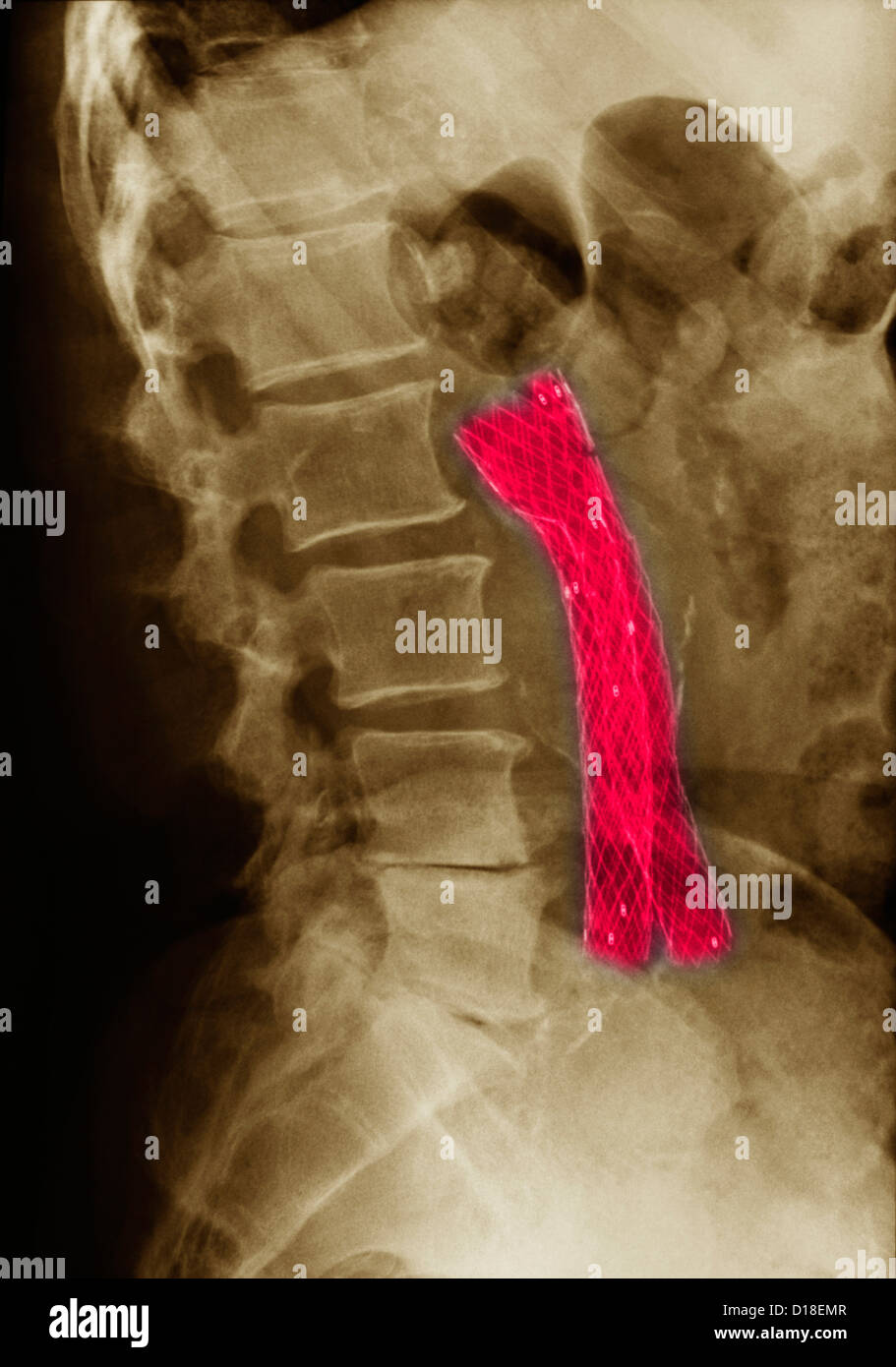 X-ray zeigt ein Schutzgitter Aorto-Beckenkamm Bypass graft ...
