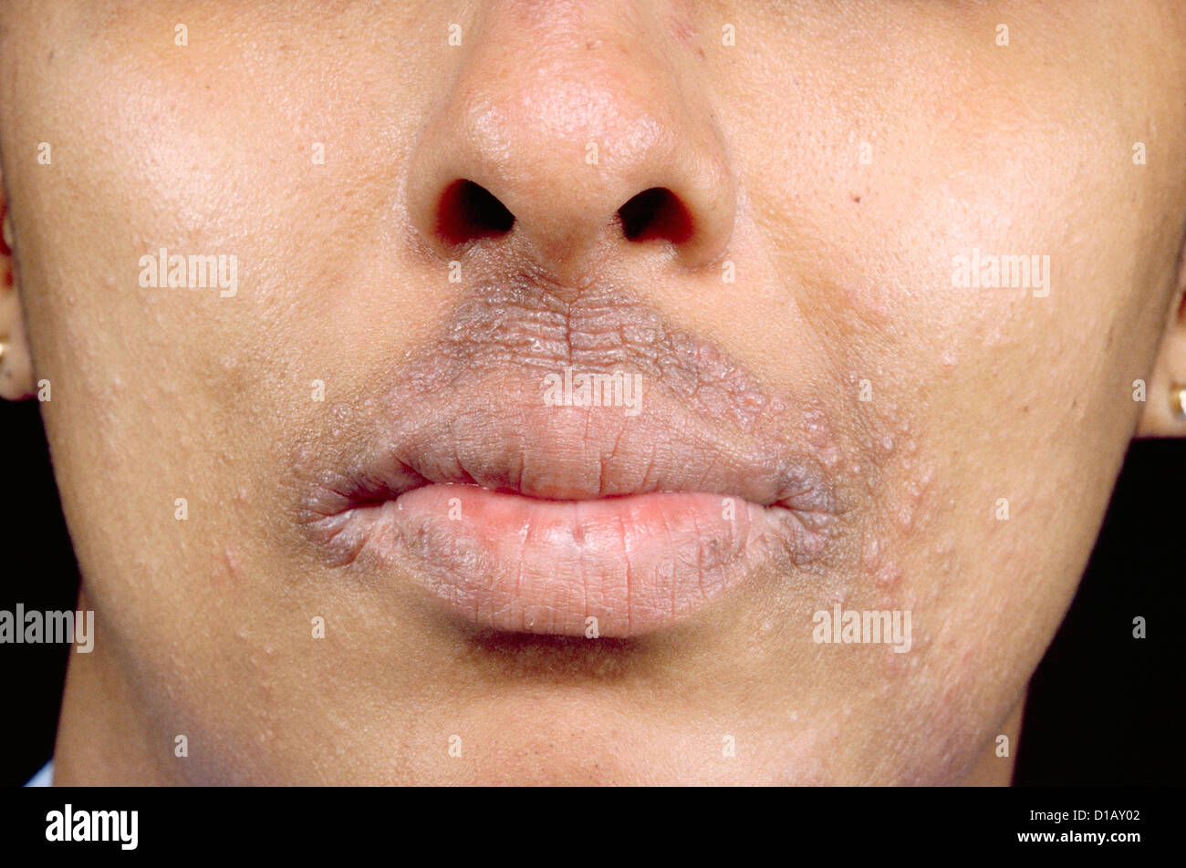 Neurodermitis gesicht -Fotos und -Bildmaterial in hoher Auflösung – Alamy