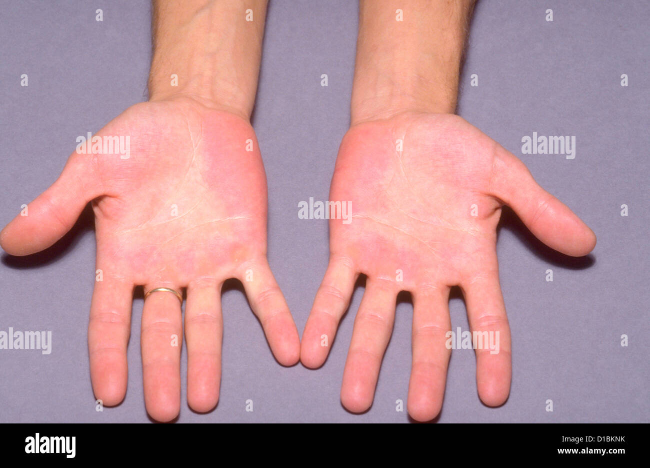 Palmares erythem -Fotos und -Bildmaterial in hoher Auflösung – Alamy