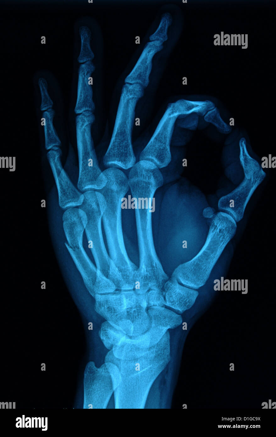 Roentgen hand -Fotos und -Bildmaterial in hoher Auflösung – Alamy