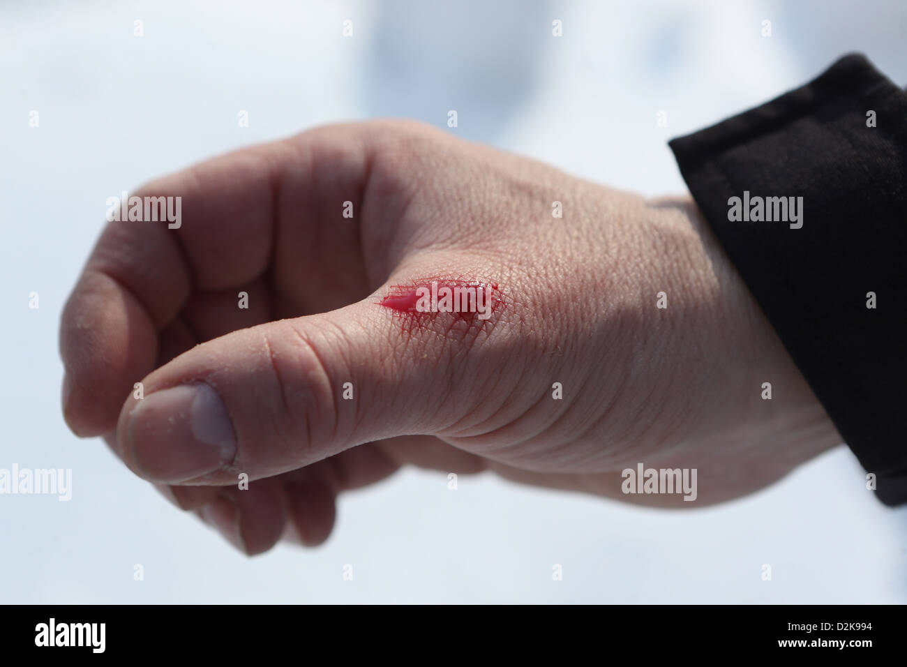 Wound infection -Fotos und -Bildmaterial in hoher Auflösung – Alamy