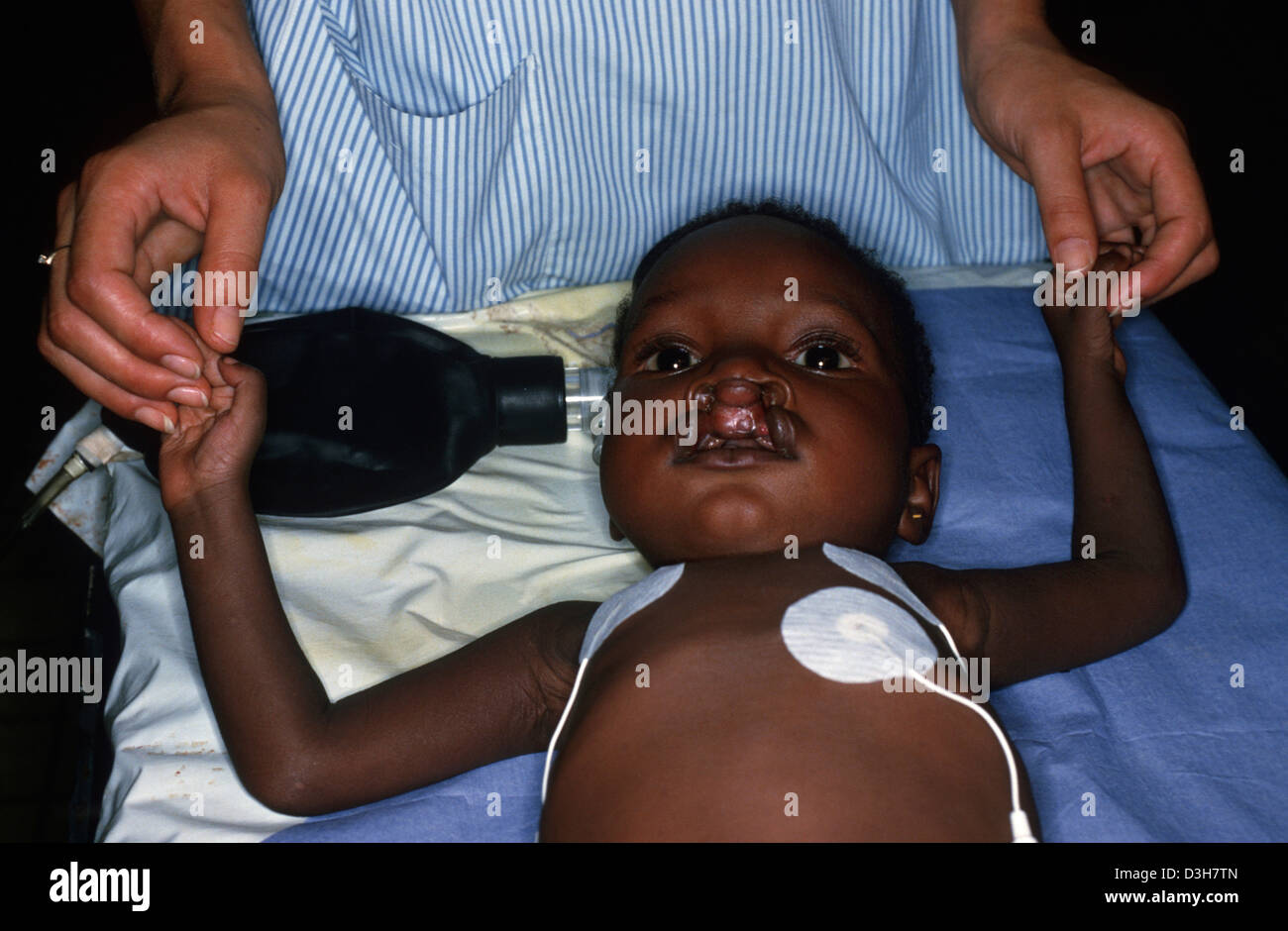 Cleft Palate Stockfotos und -bilder Kaufen - Alamy