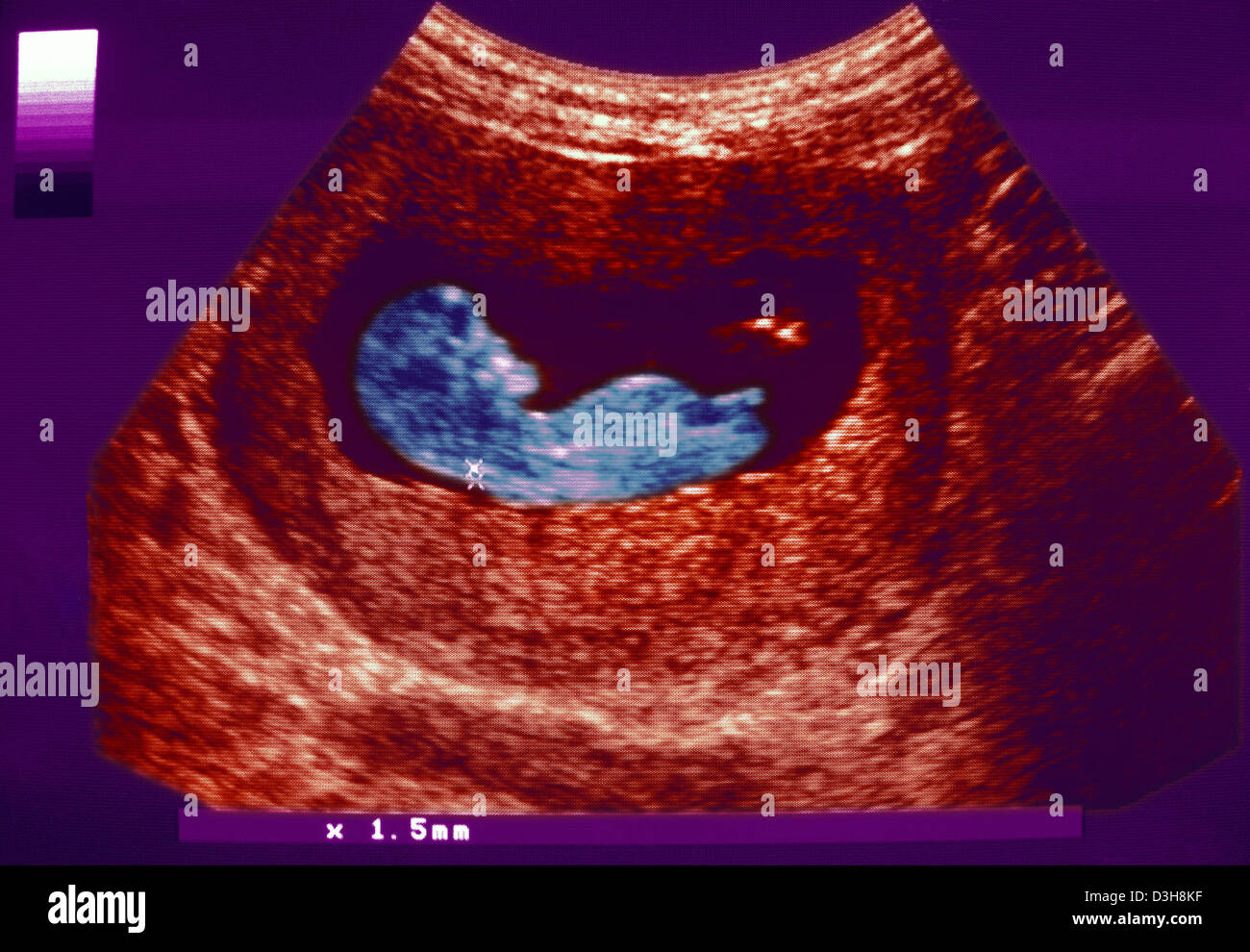 Fetale messung Stockfotos und -bilder Kaufen - Alamy
