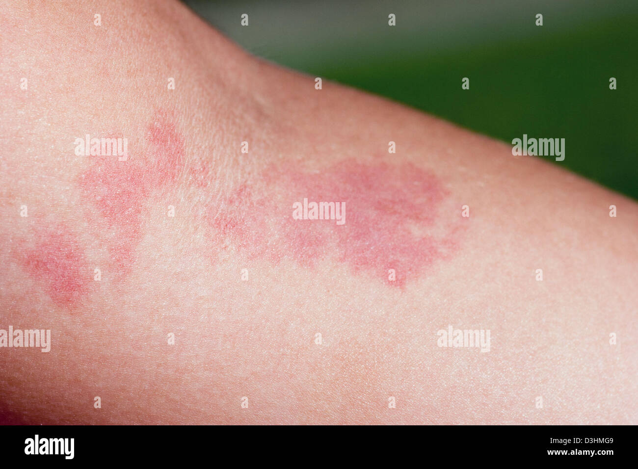 Kirsche angioma -Fotos und -Bildmaterial in hoher Auflösung – Alamy