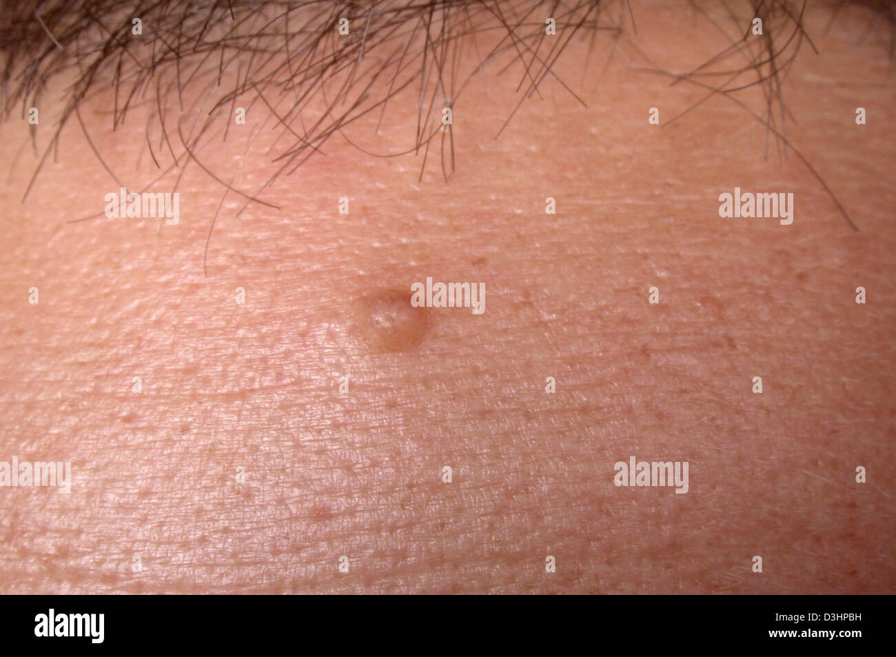 Gutartiger hauttumor gesicht -Fotos und -Bildmaterial in hoher ...