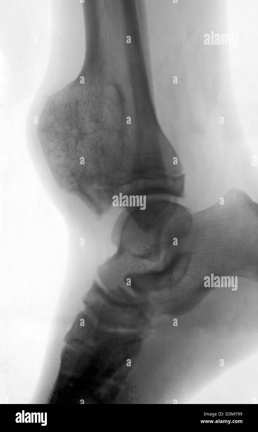 X-ray zeigt einen Tumor der distalen tibia Stockfotografie - Alamy