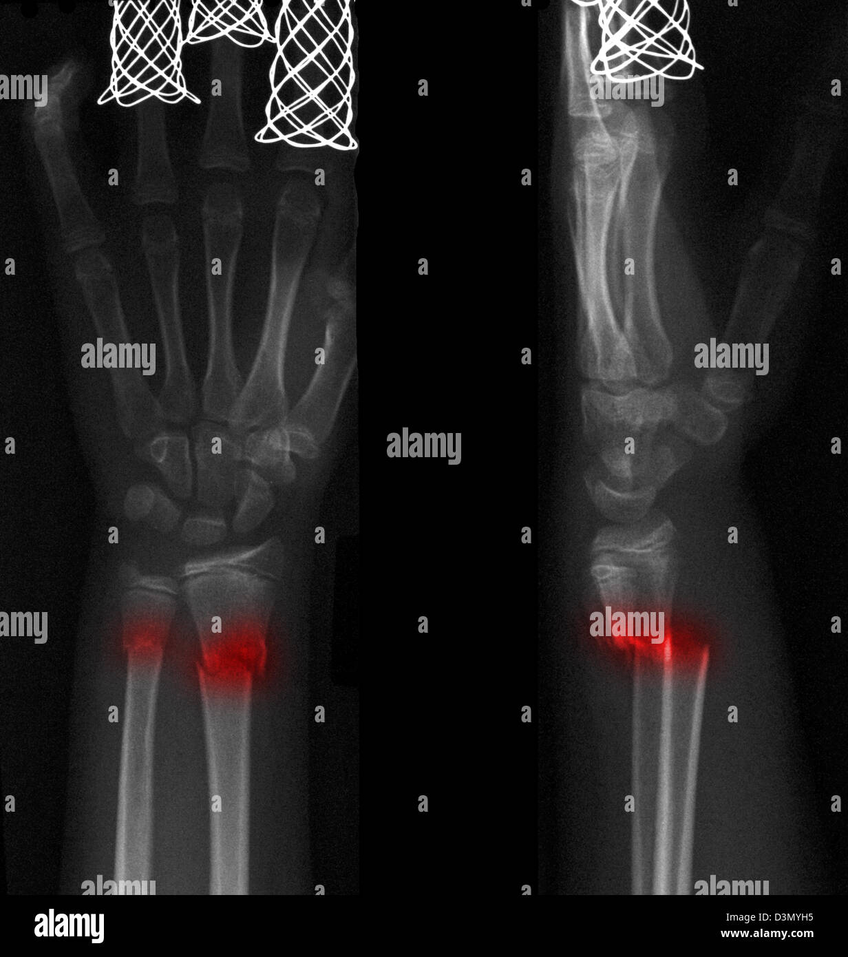 x-ray zeigen eine distale Radius und Ulna Fraktur in ein 12 Jahre altes ...