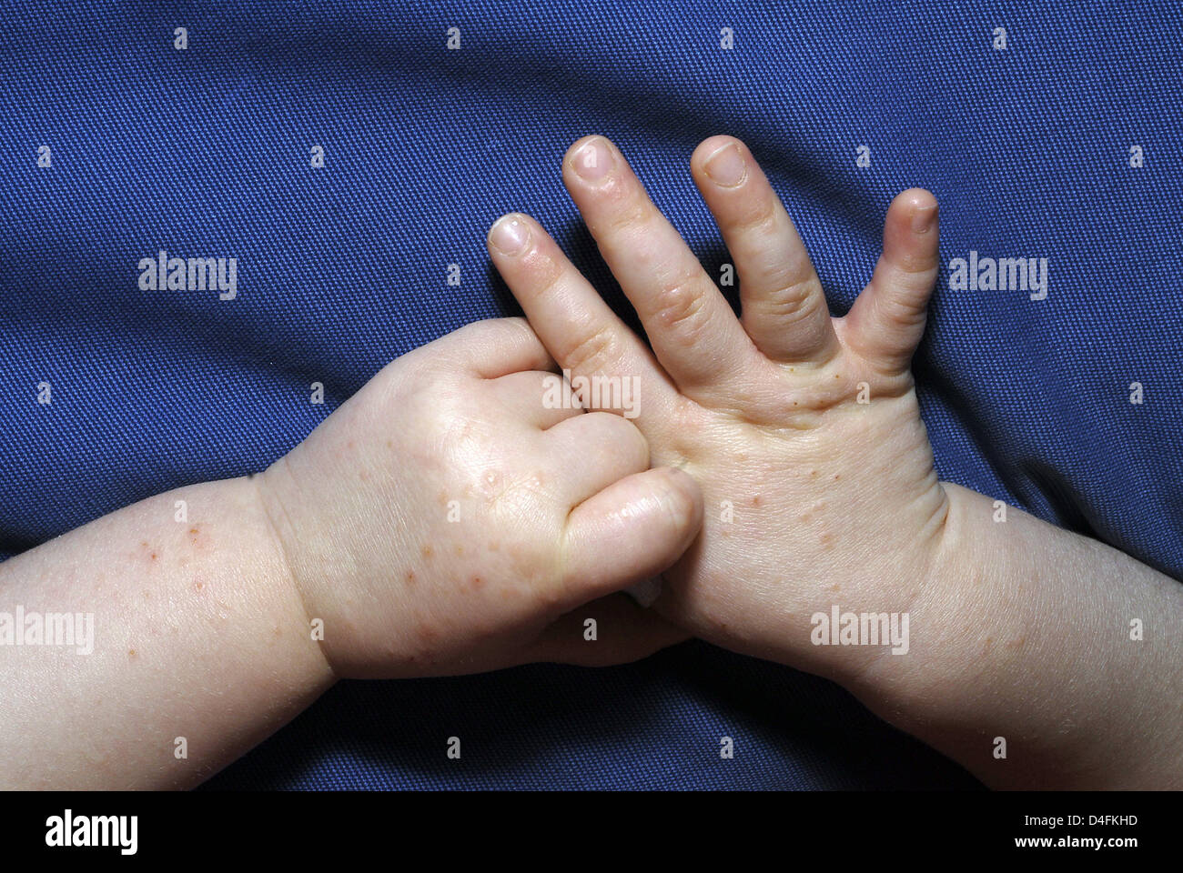 Hand fuß und mund -Fotos und -Bildmaterial in hoher Auflösung – Alamy