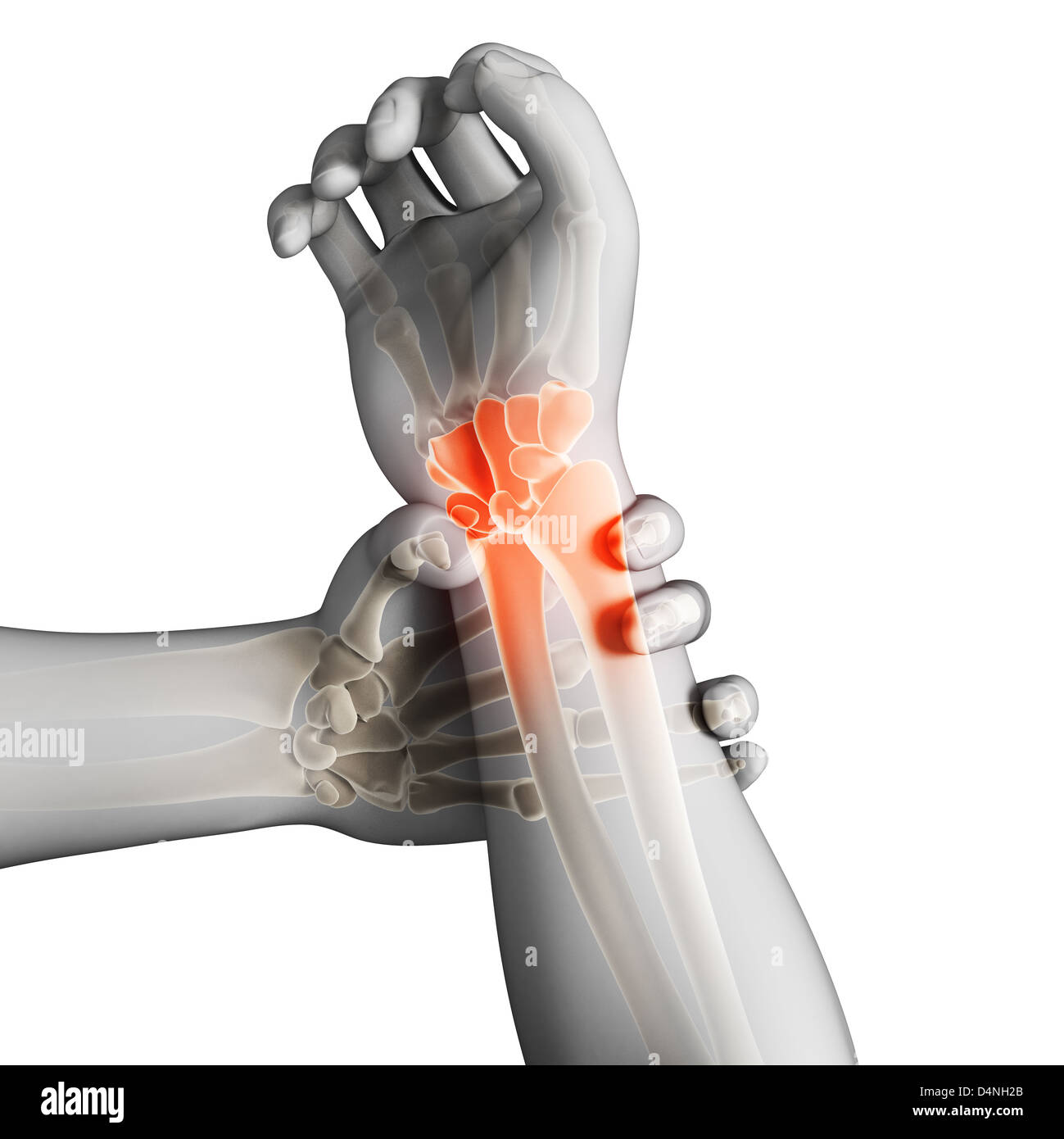 Osteoarthritis am handgelenk -Fotos und -Bildmaterial in hoher ...