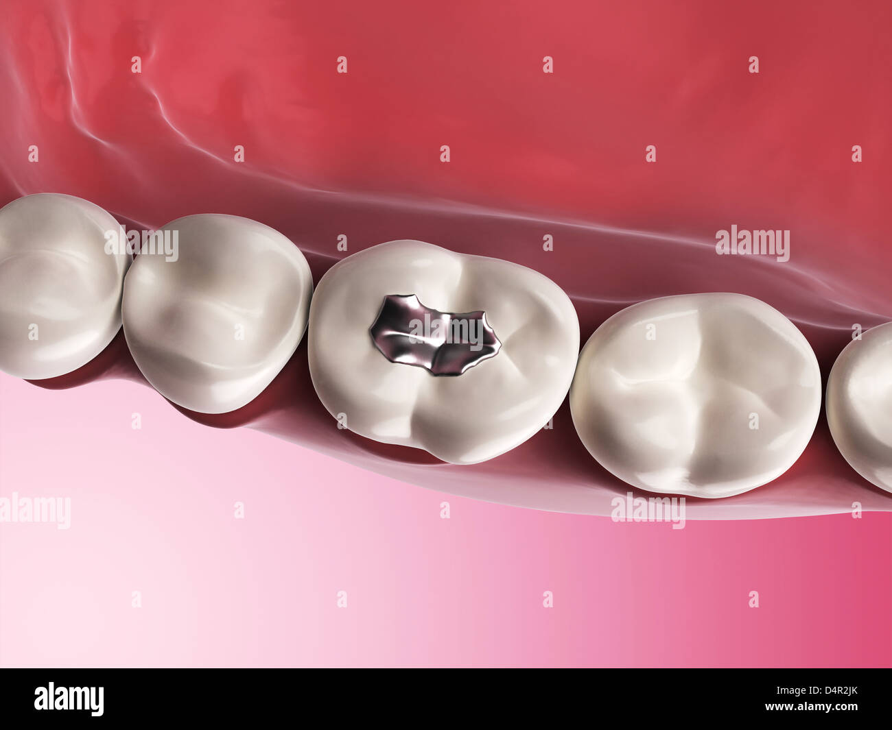 Amalgam filling -Fotos und -Bildmaterial in hoher Auflösung – Alamy