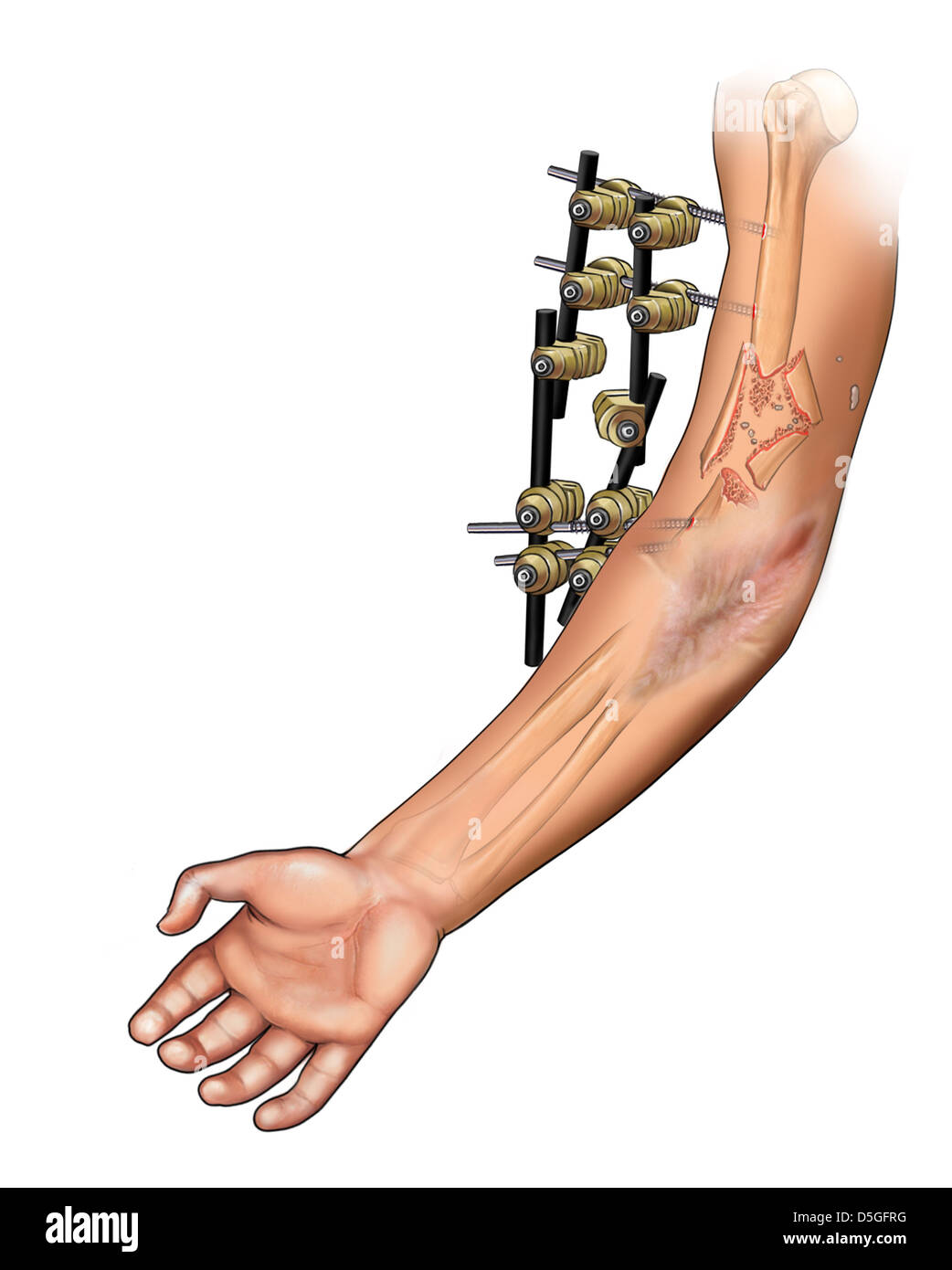 Schusswunde humerus -Fotos und -Bildmaterial in hoher Auflösung – Alamy
