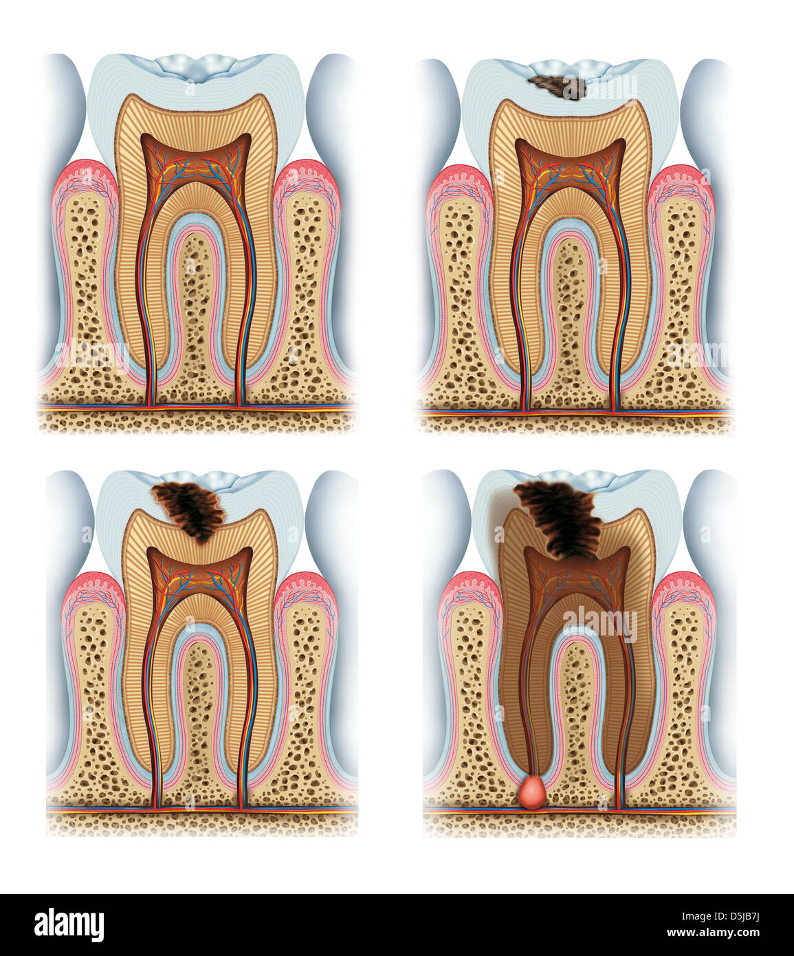 Las karies dentales -Fotos und -Bildmaterial in hoher Auflösung – Alamy