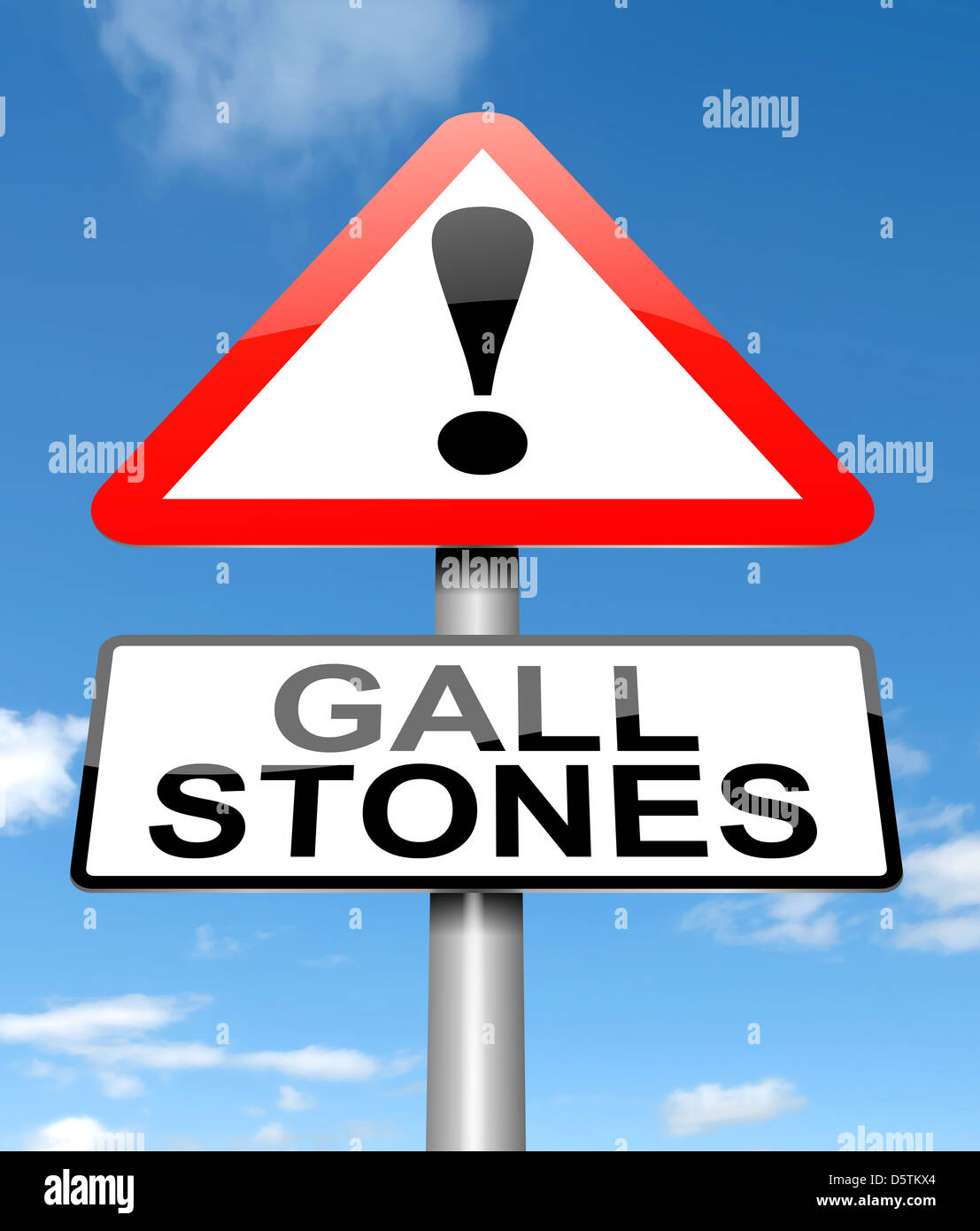 Gall bladder stones -Fotos und -Bildmaterial in hoher Auflösung – Alamy