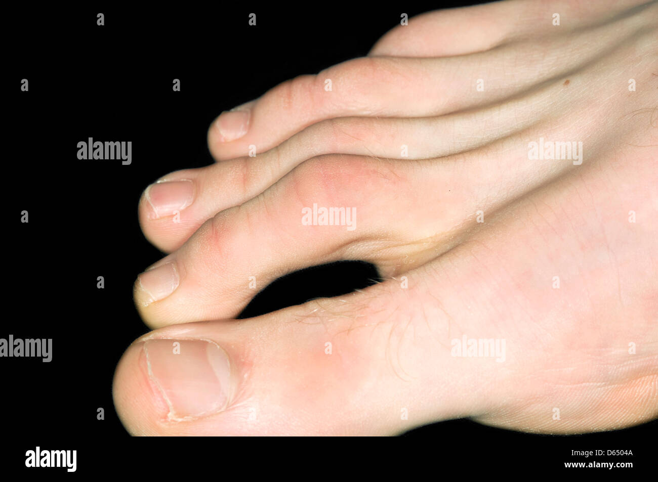Toe medical -Fotos und -Bildmaterial in hoher Auflösung – Alamy