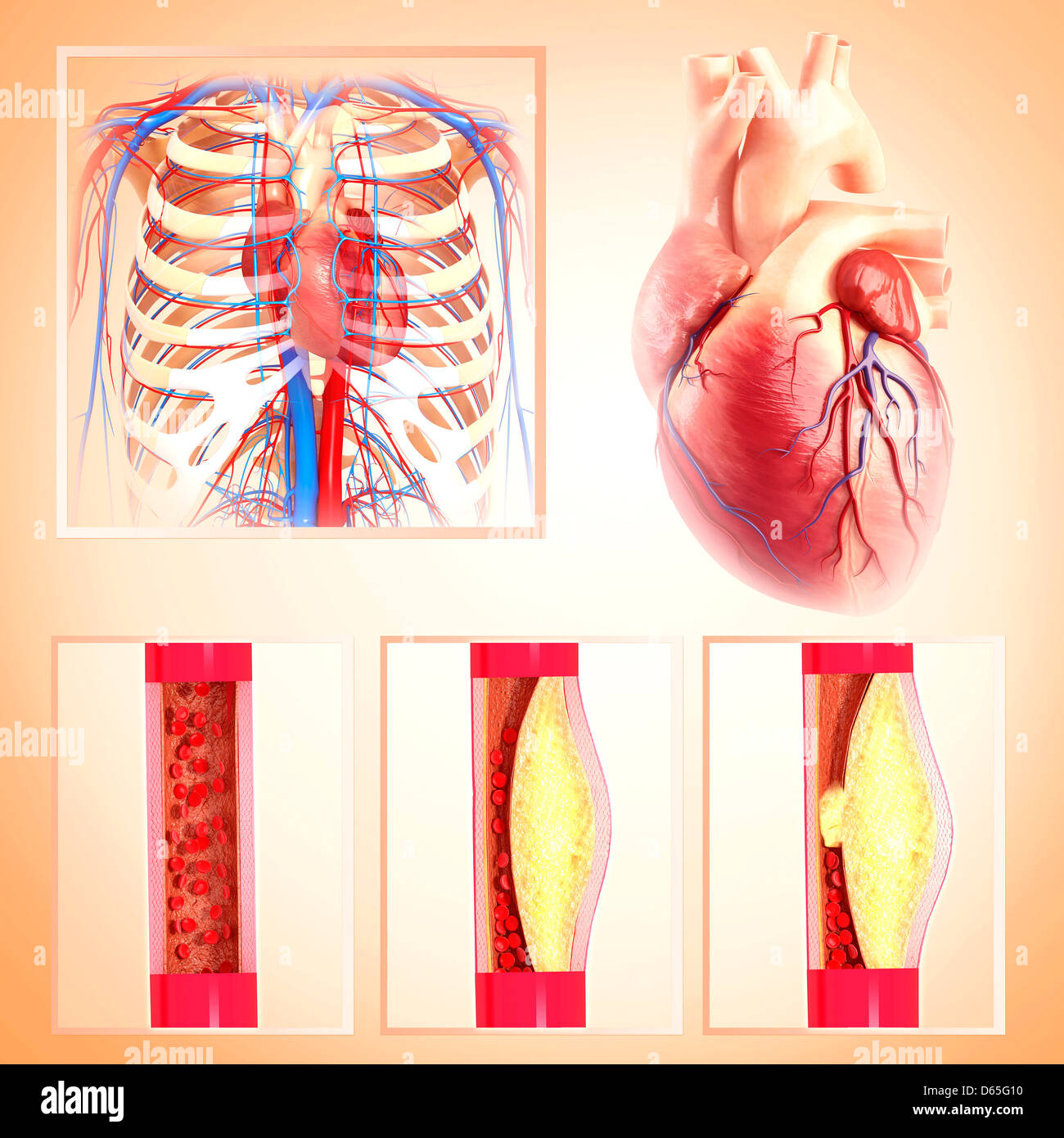 Illustration For Atherosclerosis Stockfotos und -bilder Kaufen - Alamy