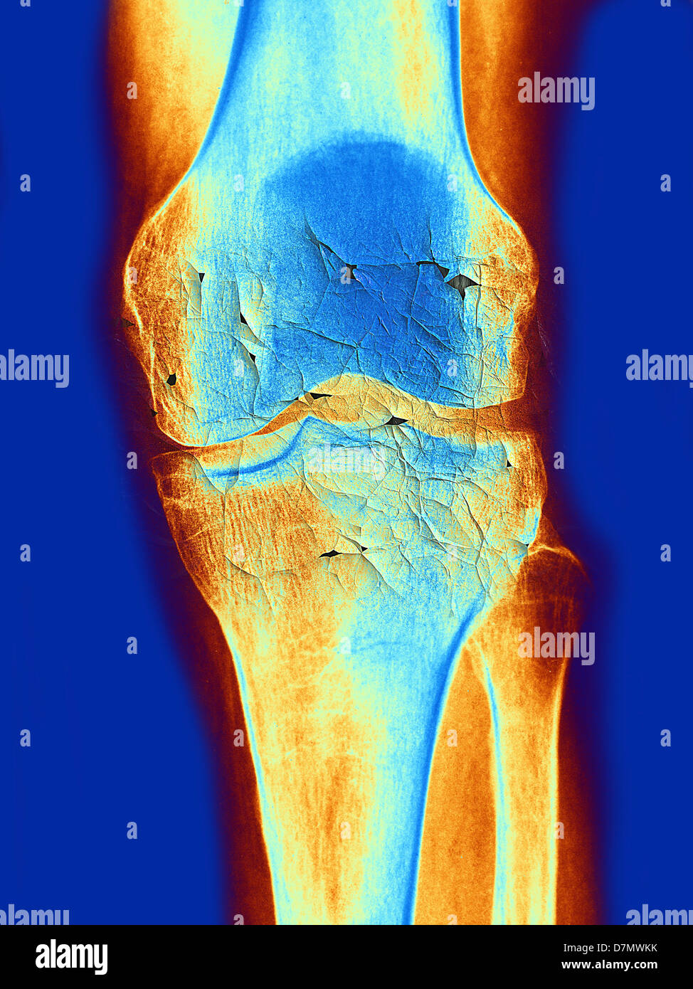 X ray human knee normal knee -Fotos und -Bildmaterial in hoher ...