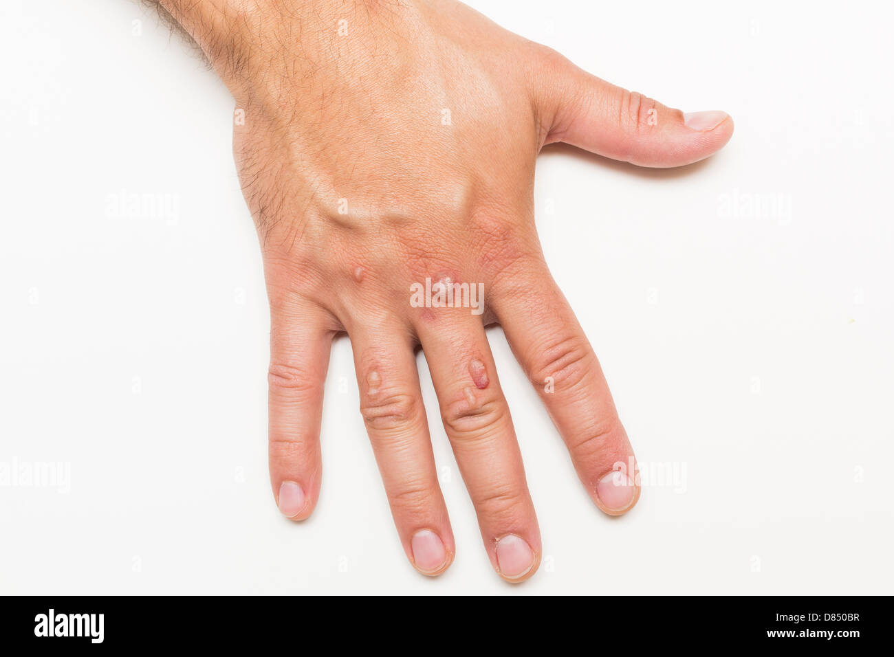 Hand des Mannes bedeckt mit Bläschen verursacht durch Kryochirurgie ...