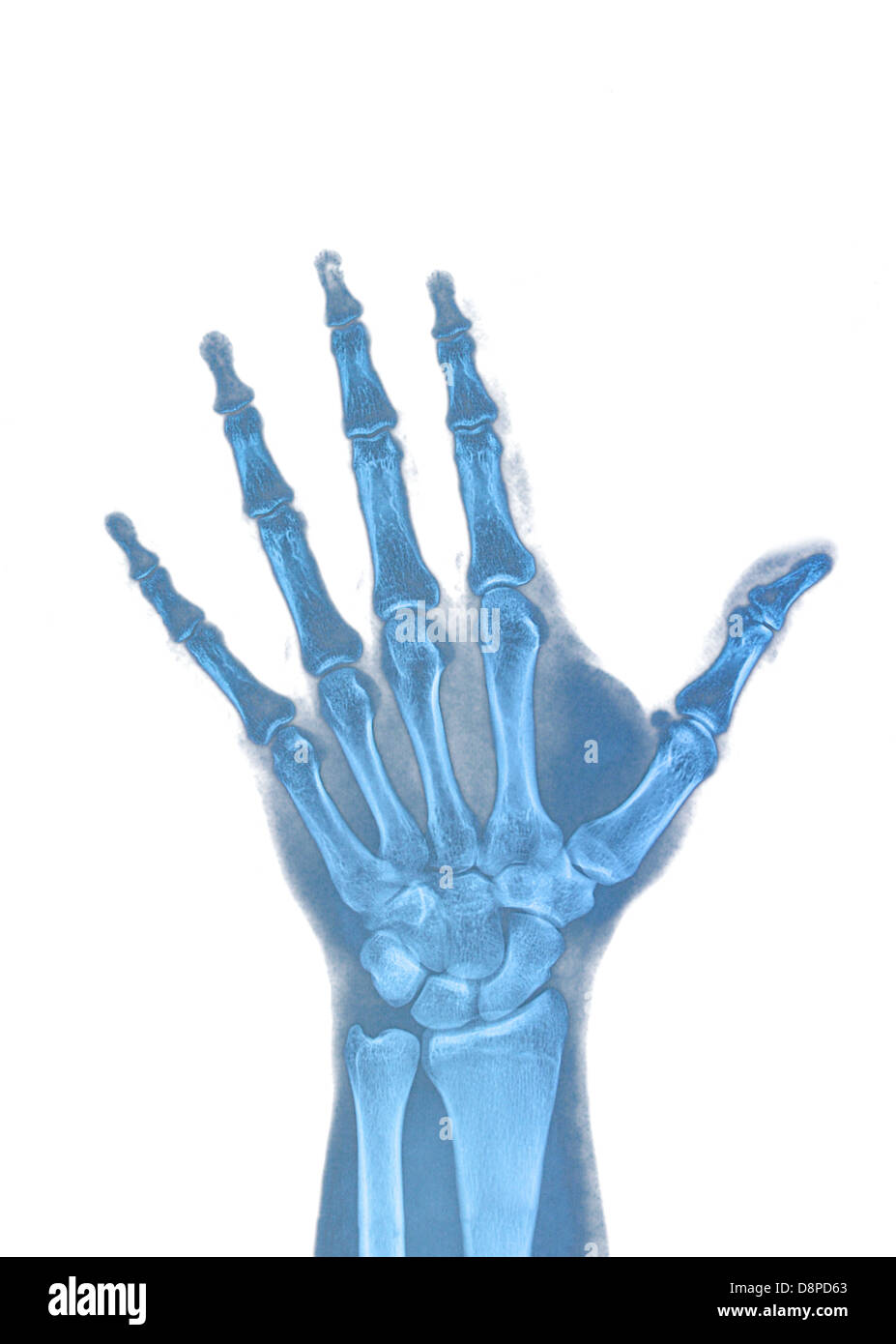 Hand Xray Bild Film Knochen Röntgen roentgen Stockfotografie - Alamy