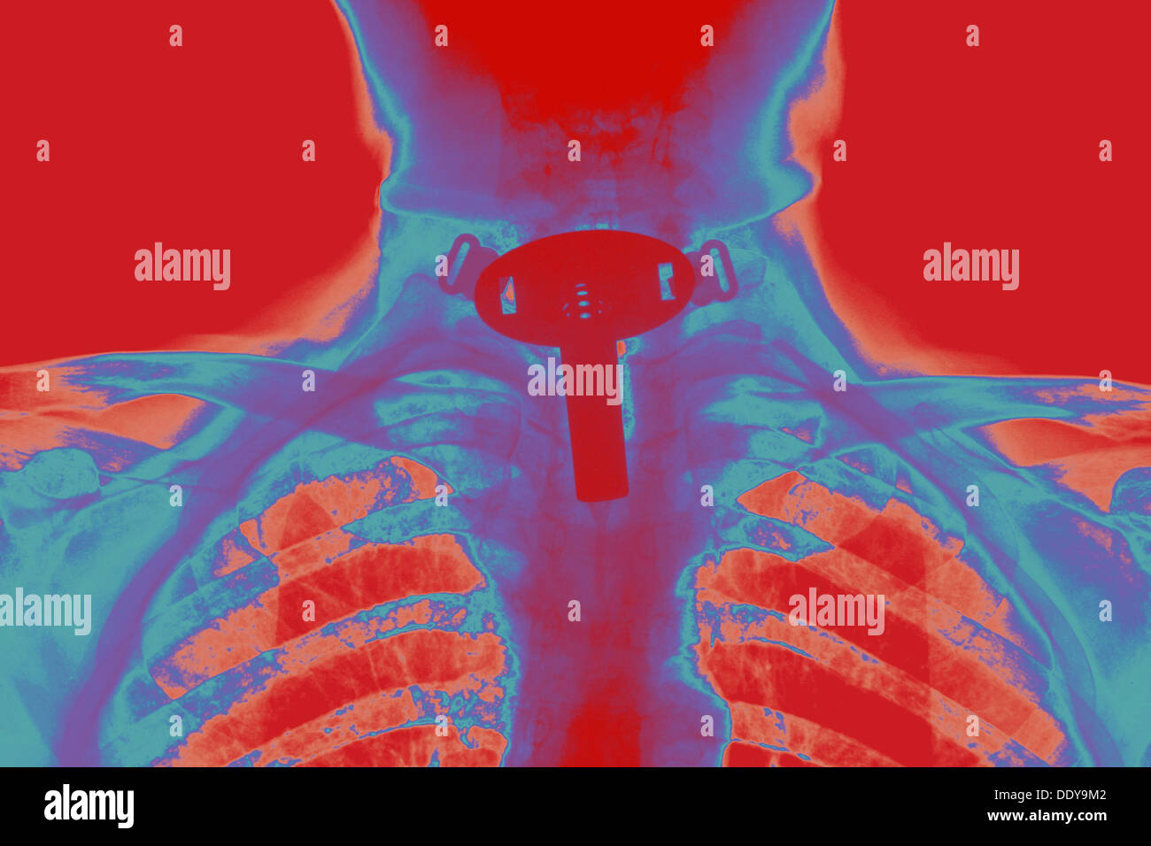 Tracheostomy Tracheotomy Stockfotos und -bilder Kaufen - Alamy