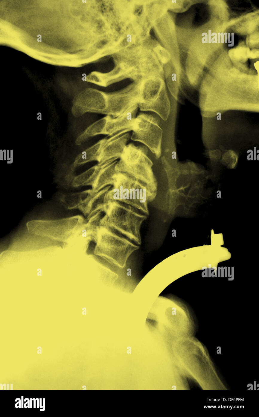 Tracheostomy Tracheotomy Stockfotos und -bilder Kaufen - Alamy