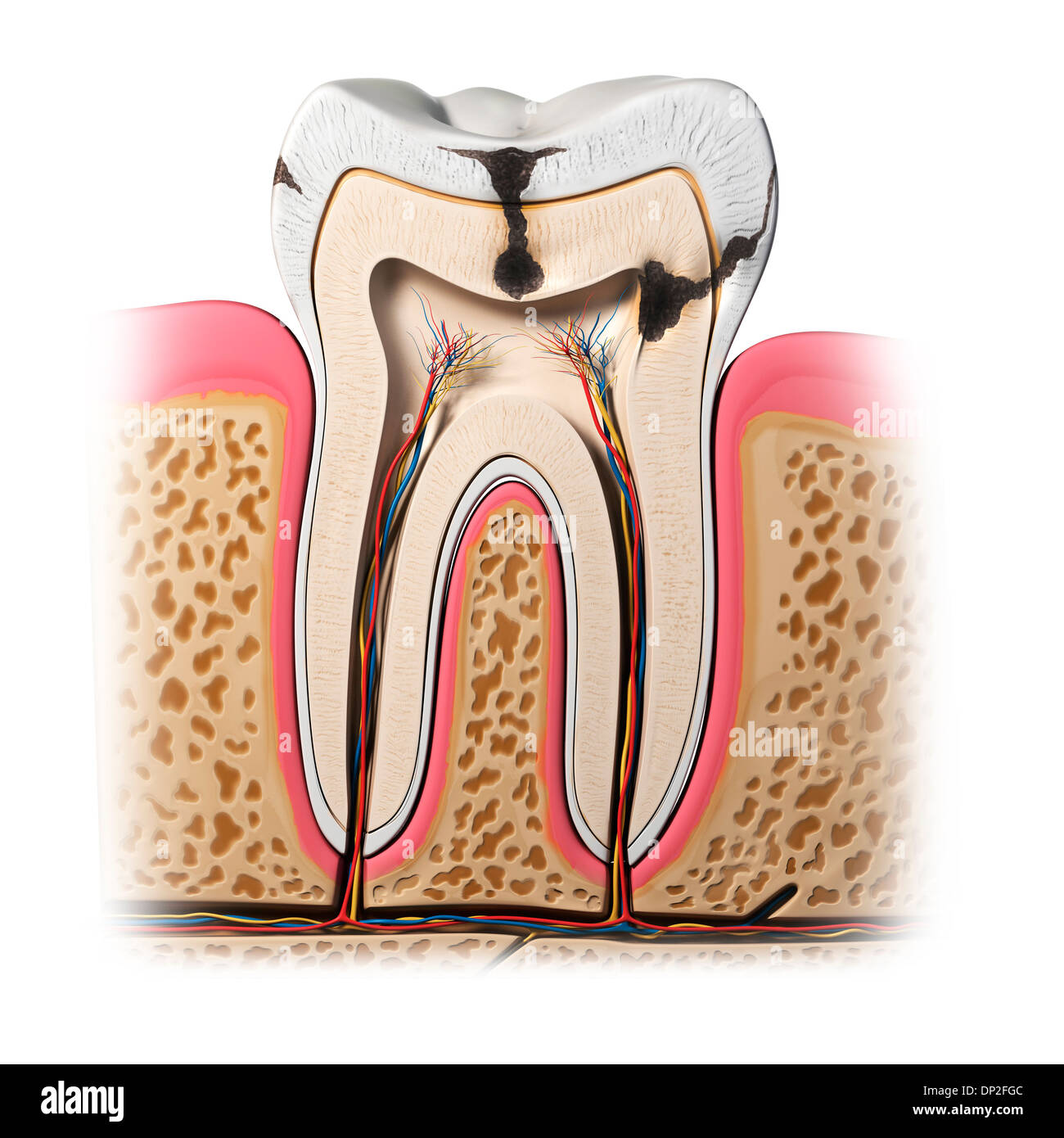 Tooth decay -Fotos und -Bildmaterial in hoher Auflösung – Alamy