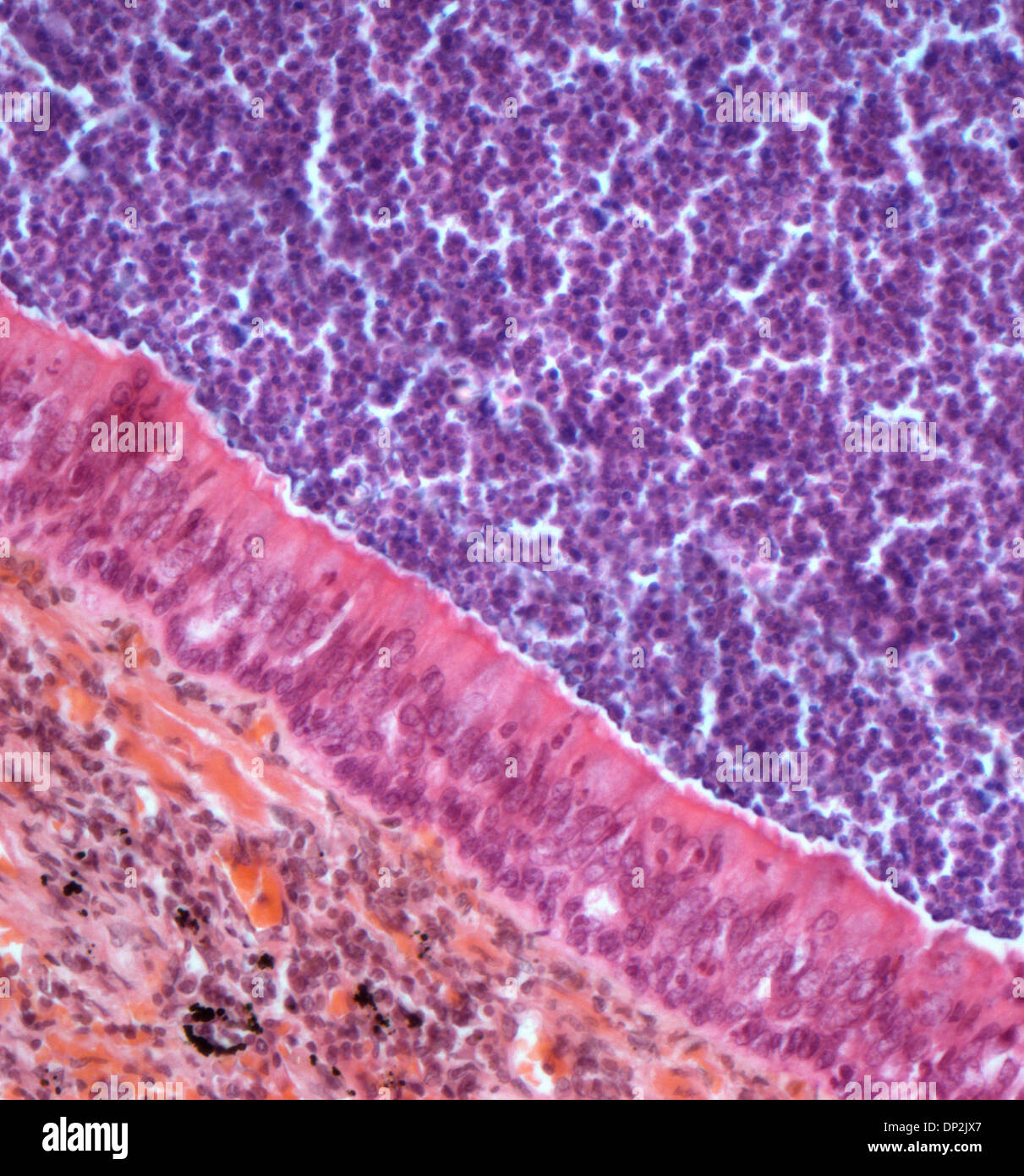 Bronchitis -Fotos und -Bildmaterial in hoher Auflösung – Alamy