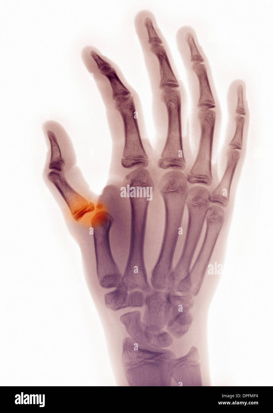 Röntgen der Hand zeigt Daumen Luxation Stockfotografie - Alamy Röntgen der Hand zeigt Daumen Luxation Stockfotografie - Alamy