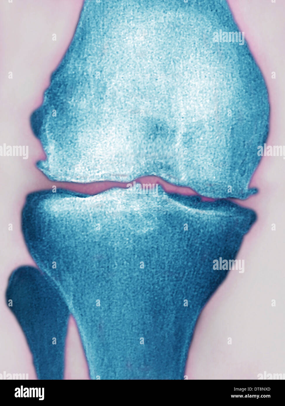 Arthrose knie röntgen -Fotos und -Bildmaterial in hoher Auflösung – Alamy