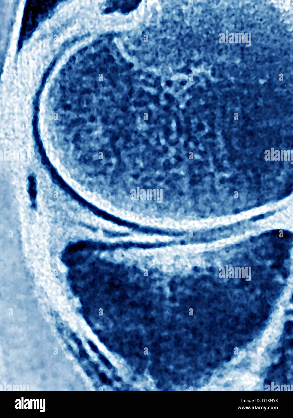 Mri des meniskus -Fotos und -Bildmaterial in hoher Auflösung – Alamy