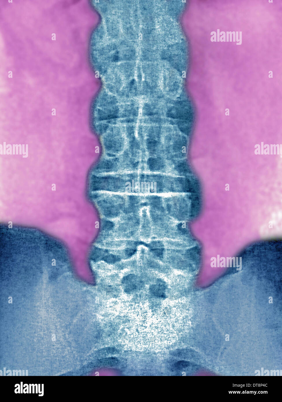 Spondylitis ankylose -Fotos und -Bildmaterial in hoher Auflösung – Alamy