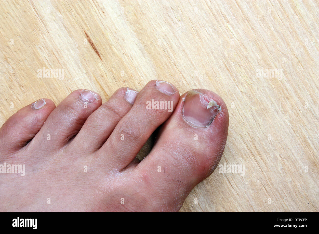 Eklige hässliche füße -Fotos und -Bildmaterial in hoher Auflösung – Alamy