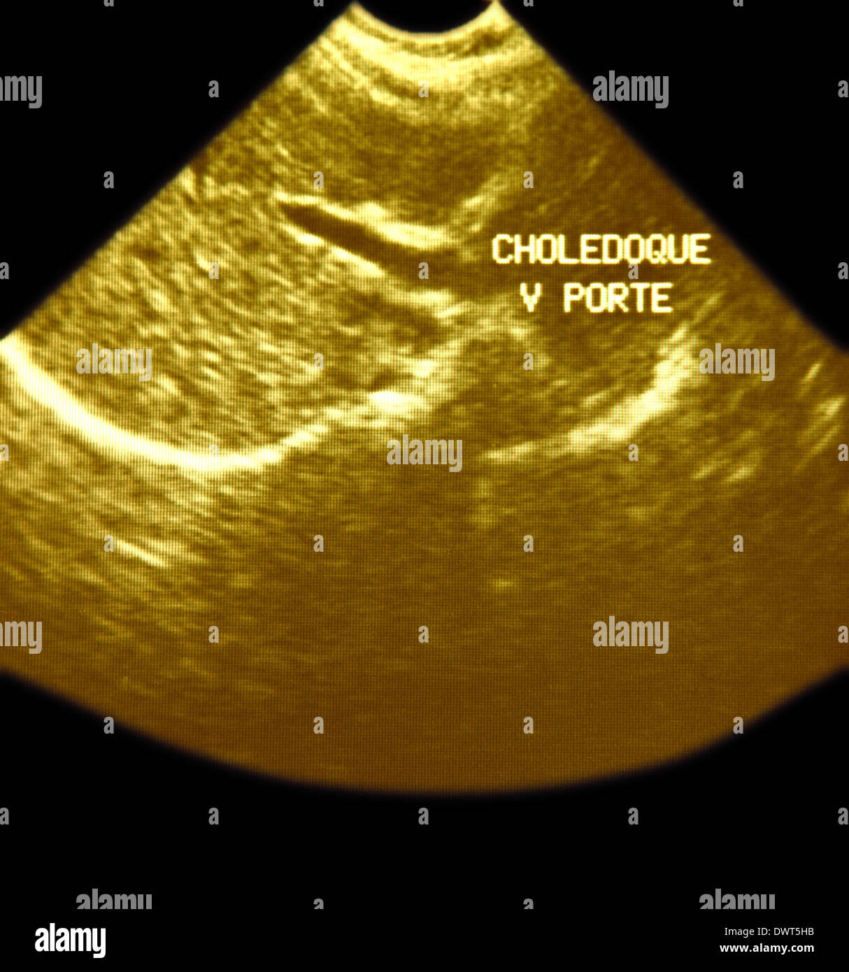 Ductus choledochus -Fotos und -Bildmaterial in hoher Auflösung – Alamy